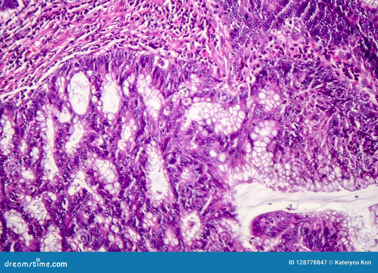 Colon Cancer Cells Under Microscope