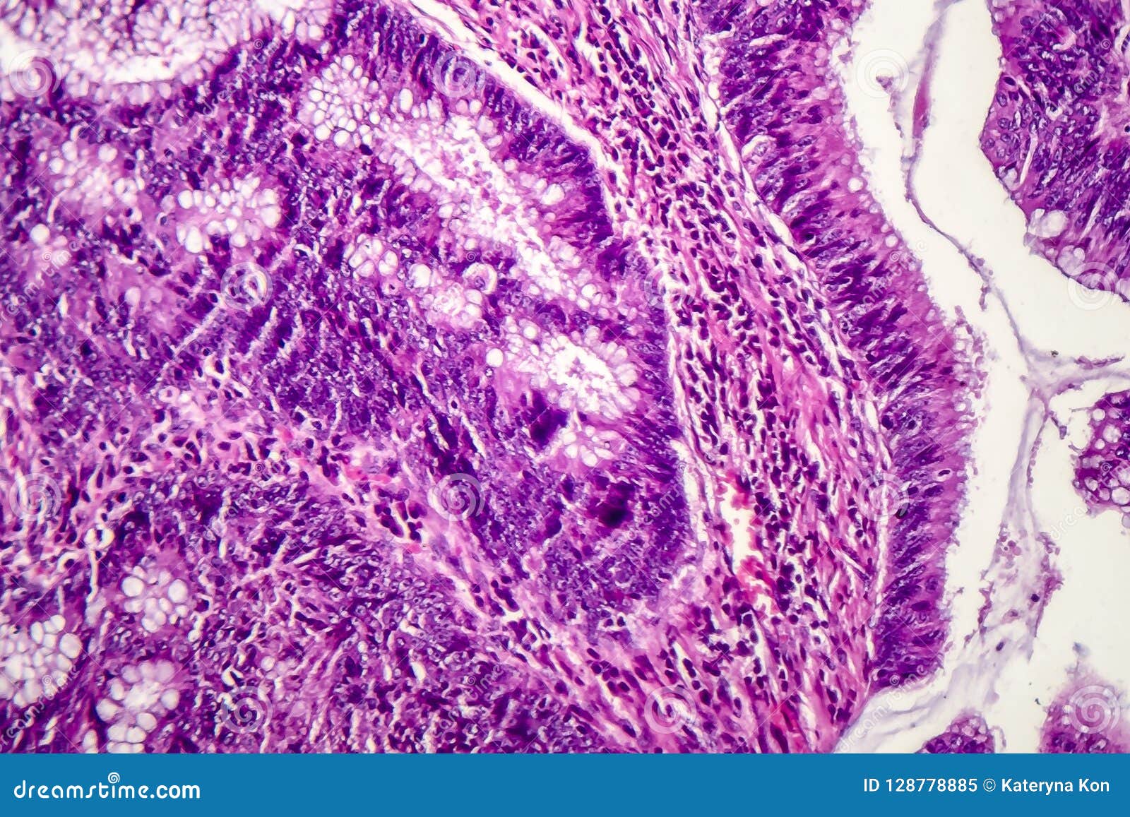 Colon Adenocarcinoma, Cancer Of Colon Royalty-Free Stock Photo ...