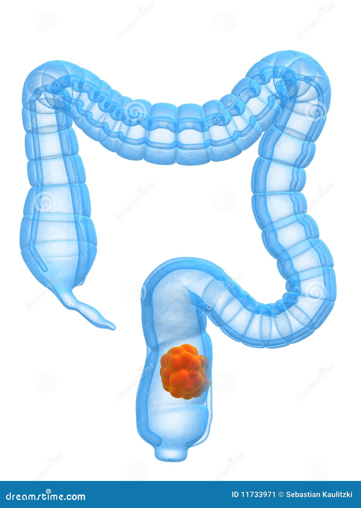 Colon Cancer Anatomy