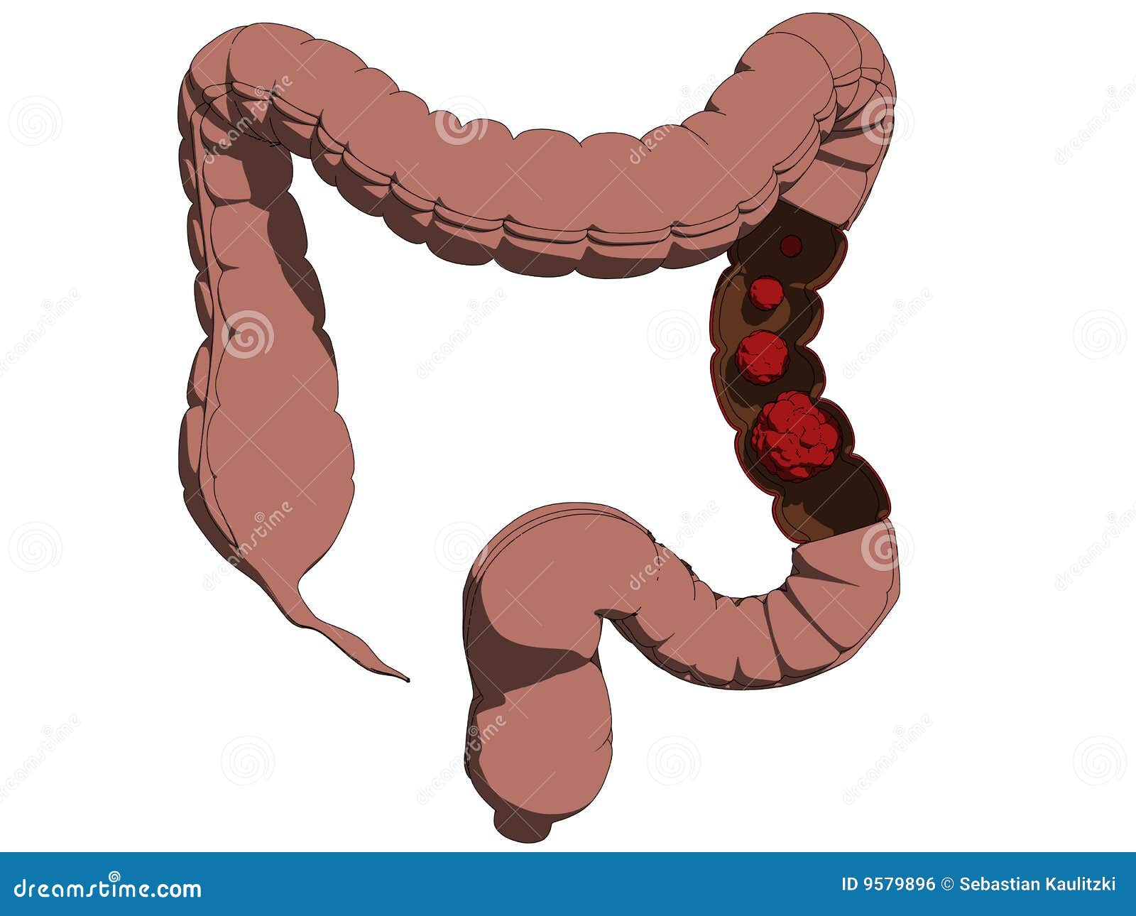 Colon cancer stock vector. Illustration of colon, health - 9579896