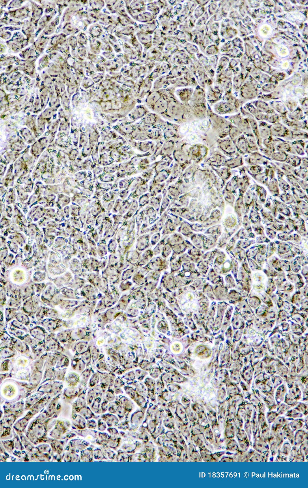 Cancer Cells Under A Microscope. Tissues Affected By Cancer Cells Under ...