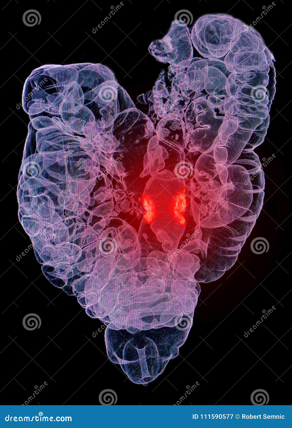Colon Cancer Illustration, CT Colonography Stock Illustration ...
