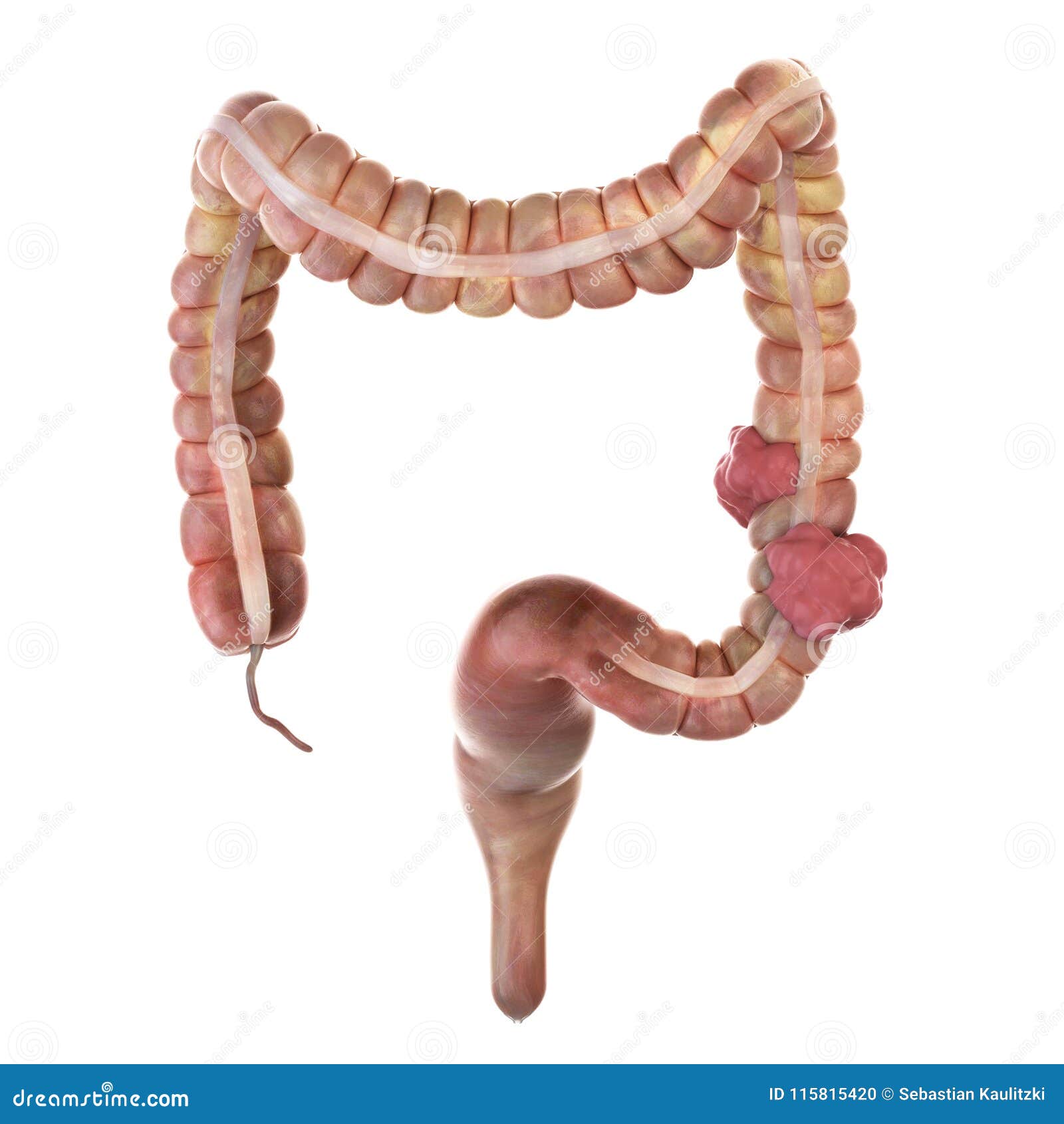 Colon Cancer Stock Illustration Illustration Of Rendering 115815420
