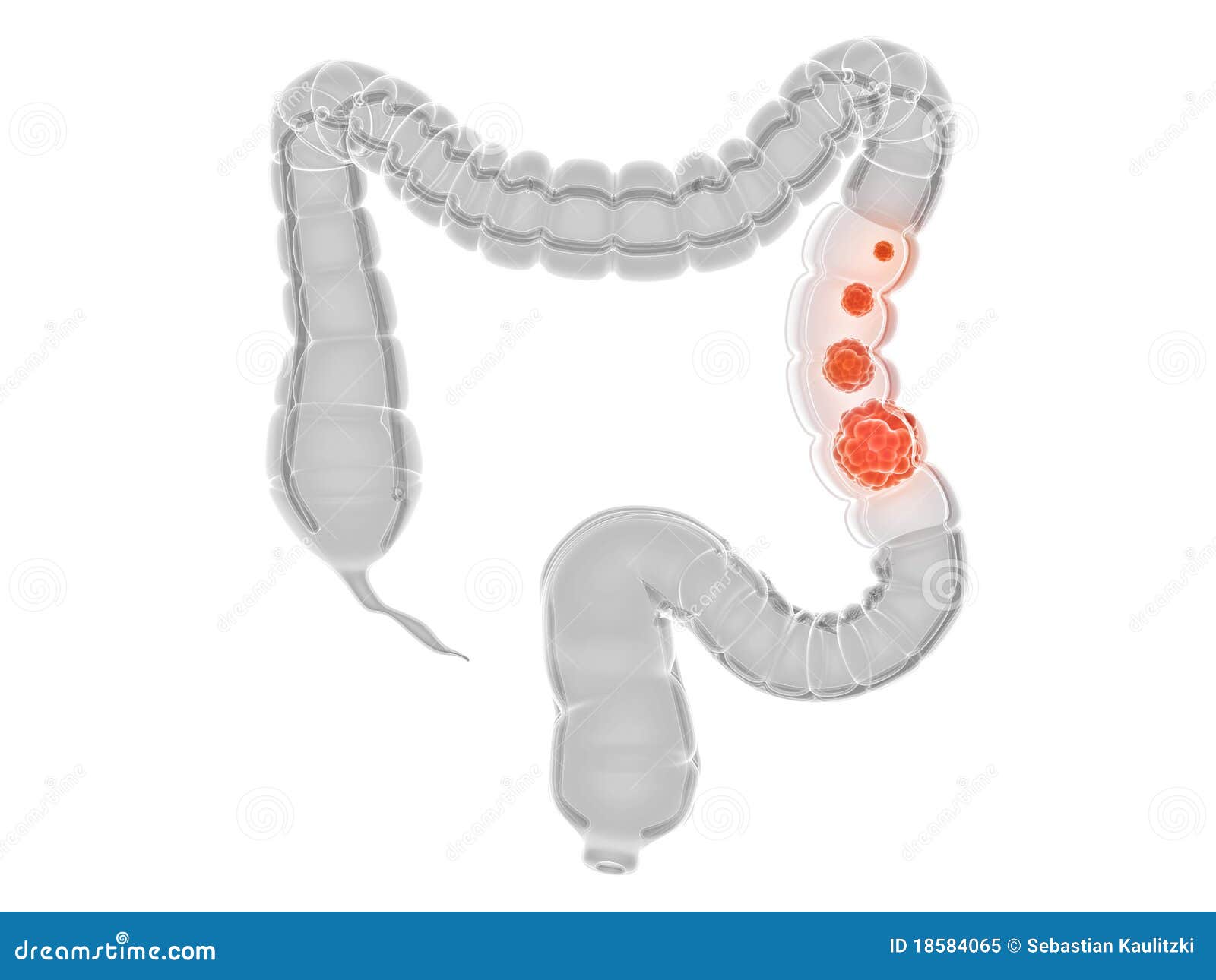 Colon cancer illustration stock illustration. Illustration of colon ...