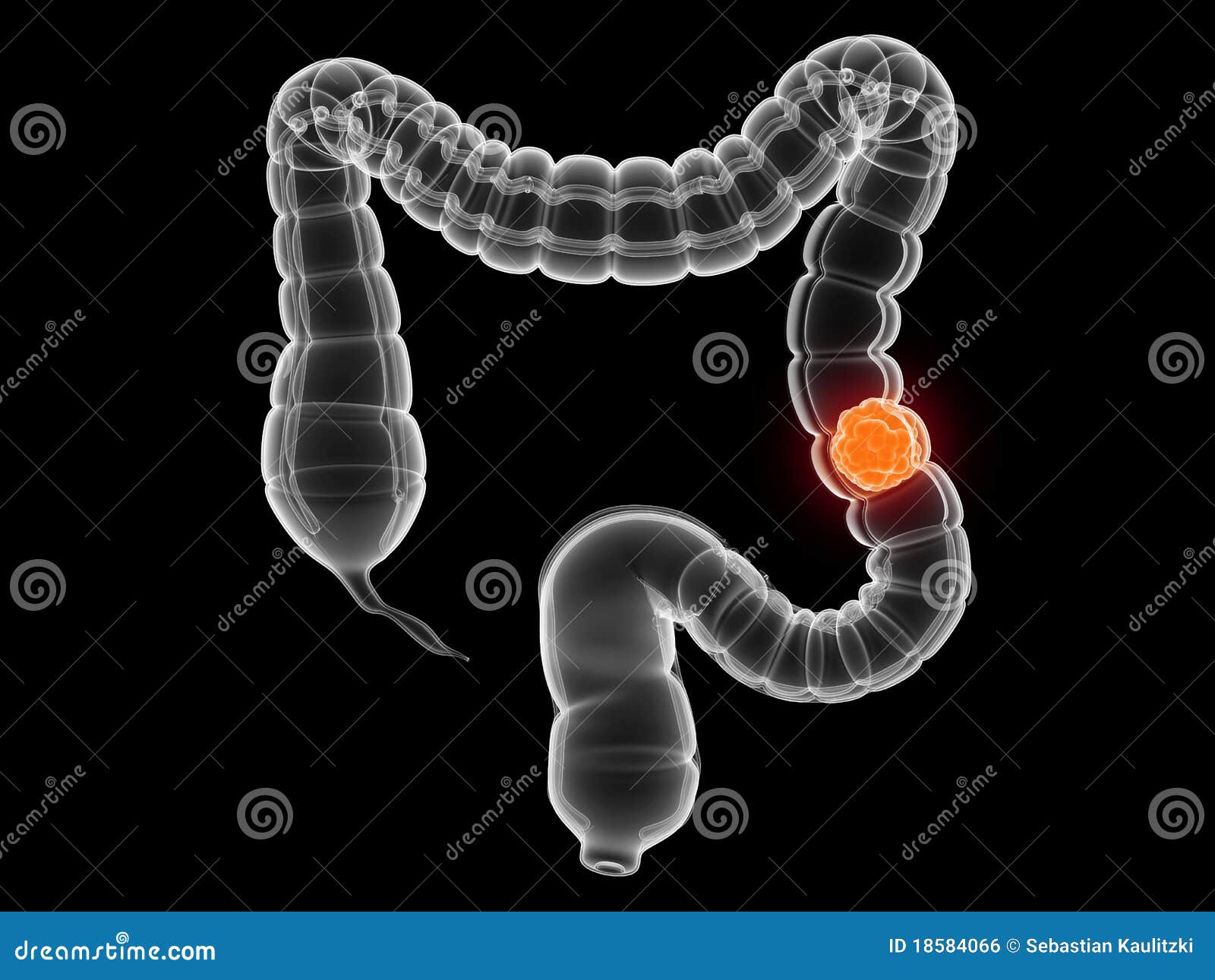 Colon Cancer Drawings