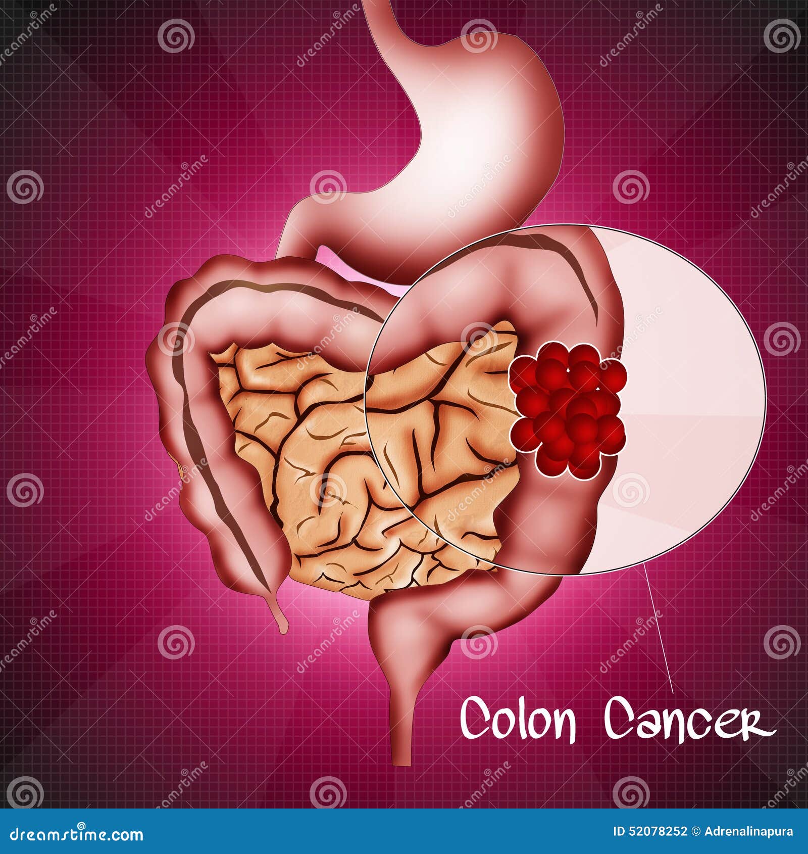Colon cancer stock illustration. Illustration of intestine - 52078252