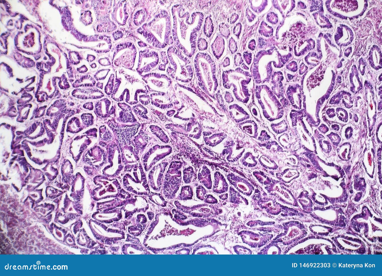 Colon Cancer, Light Micrograph Stock Illustration - Illustration of ...