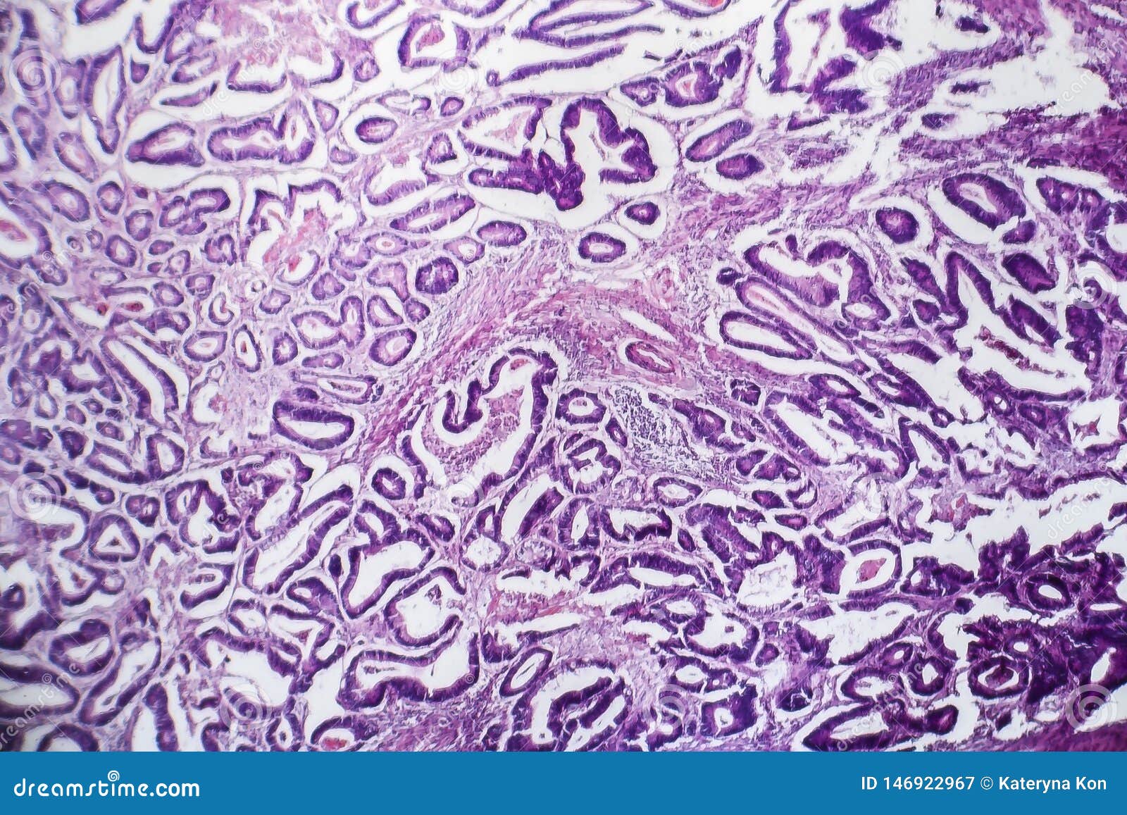 Colon Cancer, Light Micrograph Stock Illustration - Illustration of ...