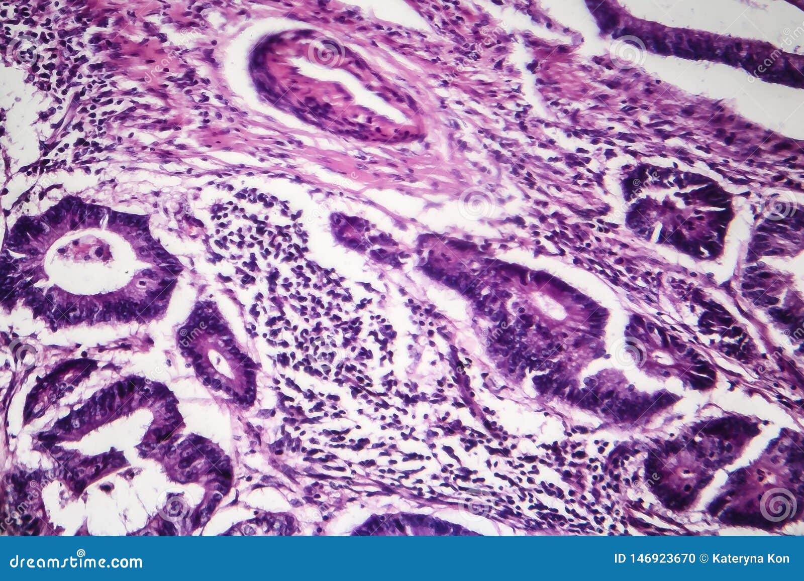 Colon Cancer, Light Micrograph Stock Photography | CartoonDealer.com ...