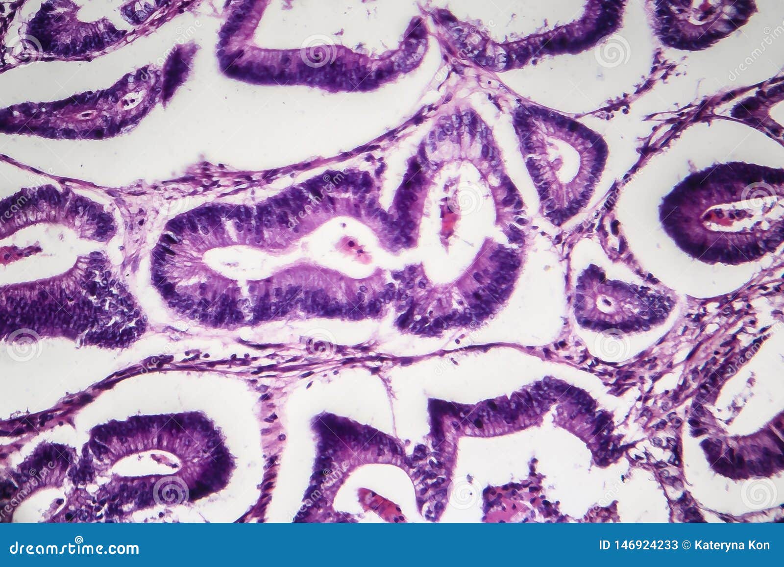 Colon Cancer, Light Micrograph Stock Illustration - Illustration of ...