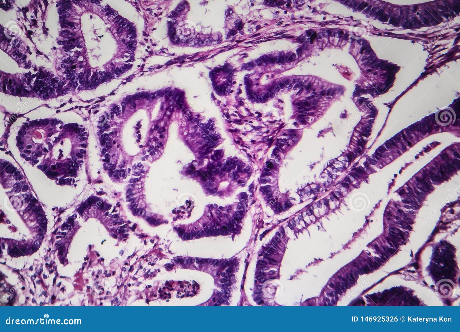 Colon Cancer, Light Micrograph Stock Illustration - Illustration of ...