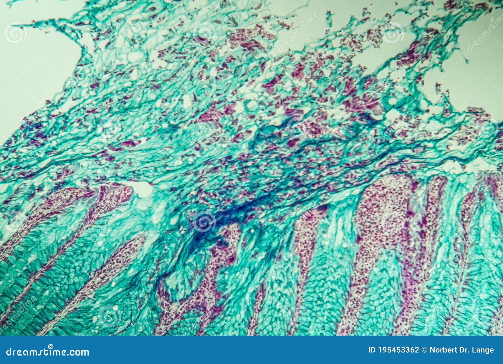 Colon Cancer Tissue Under the Microscope Stock Photo - Image of ...