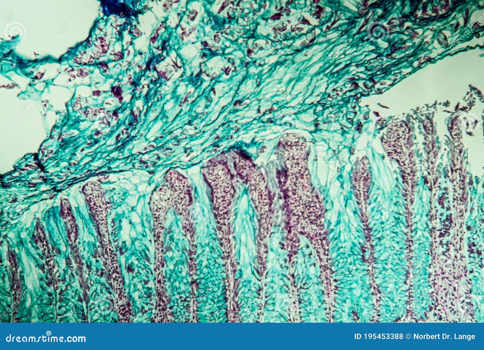 Colon Cancer Tissue Under the Microscope Stock Photo - Image of ...