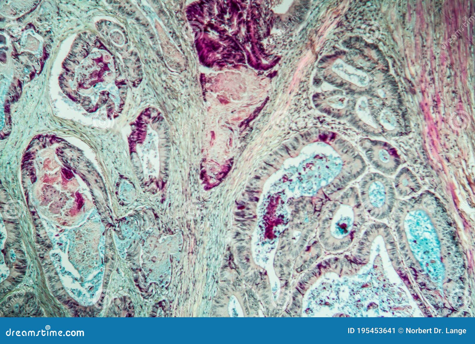 Colon Carcinoma Tissue Thin Section Stock Image - Image of ...