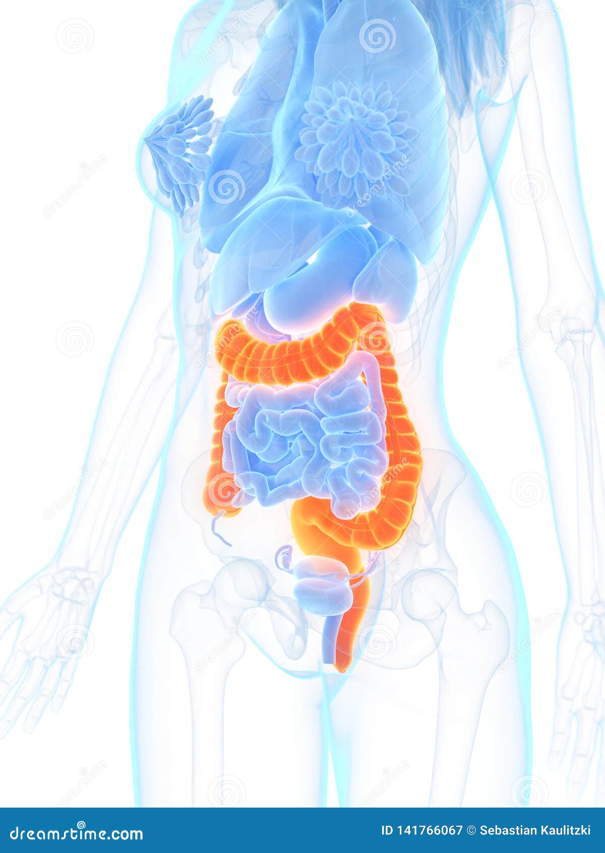 3d Illustration Of Colon Polyps Polyp In The Intestine Isolated Black