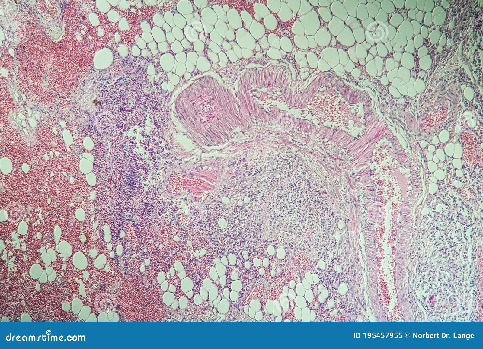 Colon Inflammation in Crohn`s Disease Stock Image - Image of chronic ...