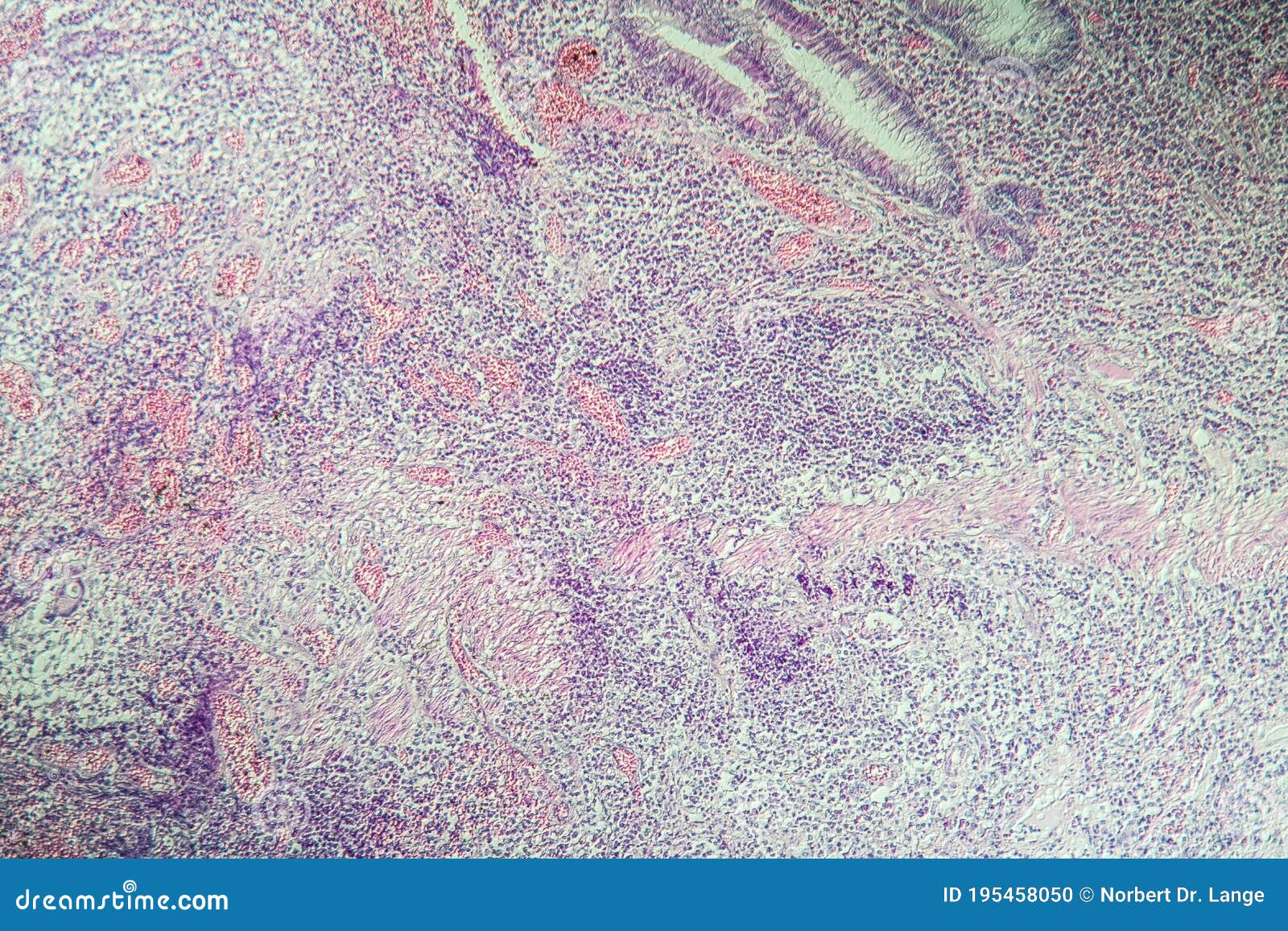 Colon Inflammation in Crohn`s Disease Stock Photo - Image of macro ...