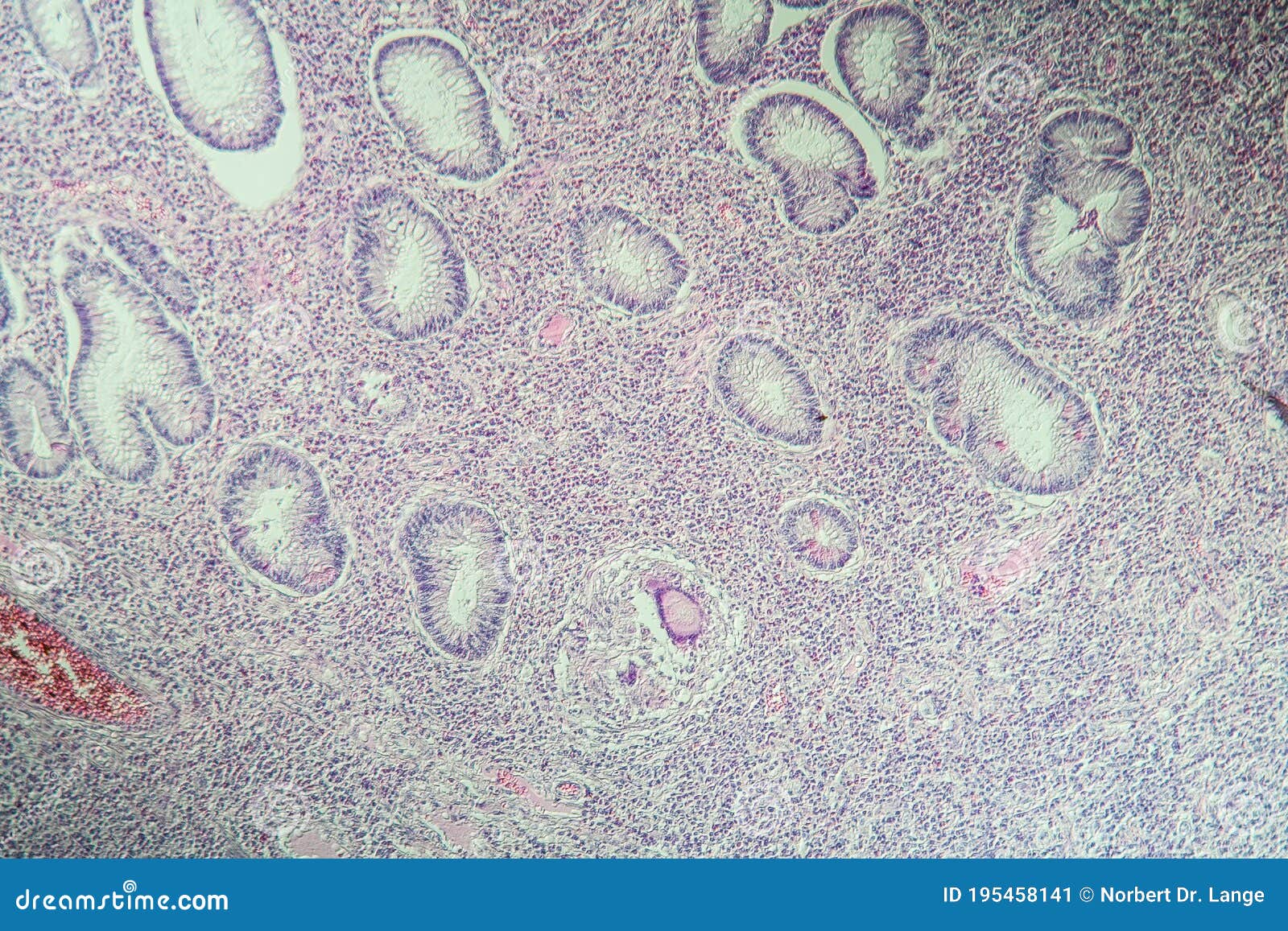 Colon Inflammation in Crohn`s Disease Stock Image - Image of crohns ...