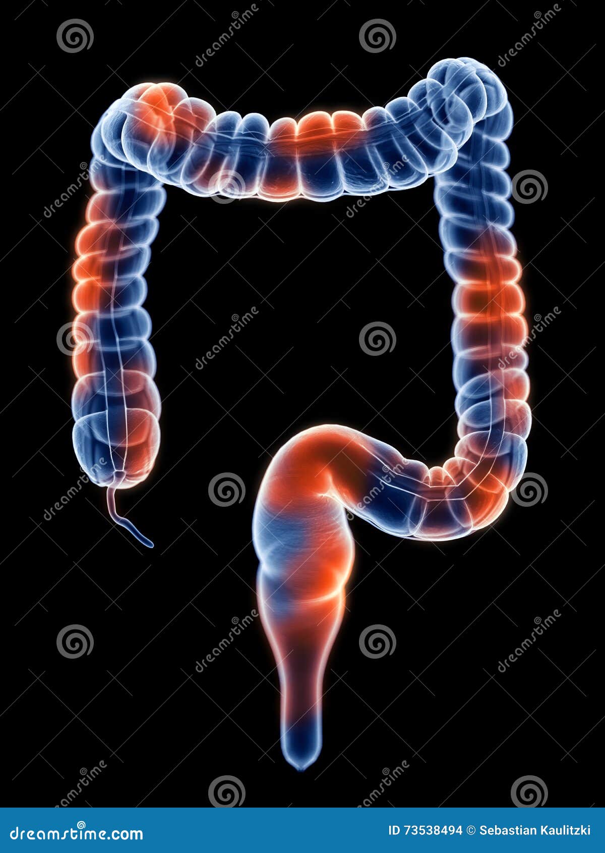 Colon inflammation stock illustration. Illustration of medicine - 73538494