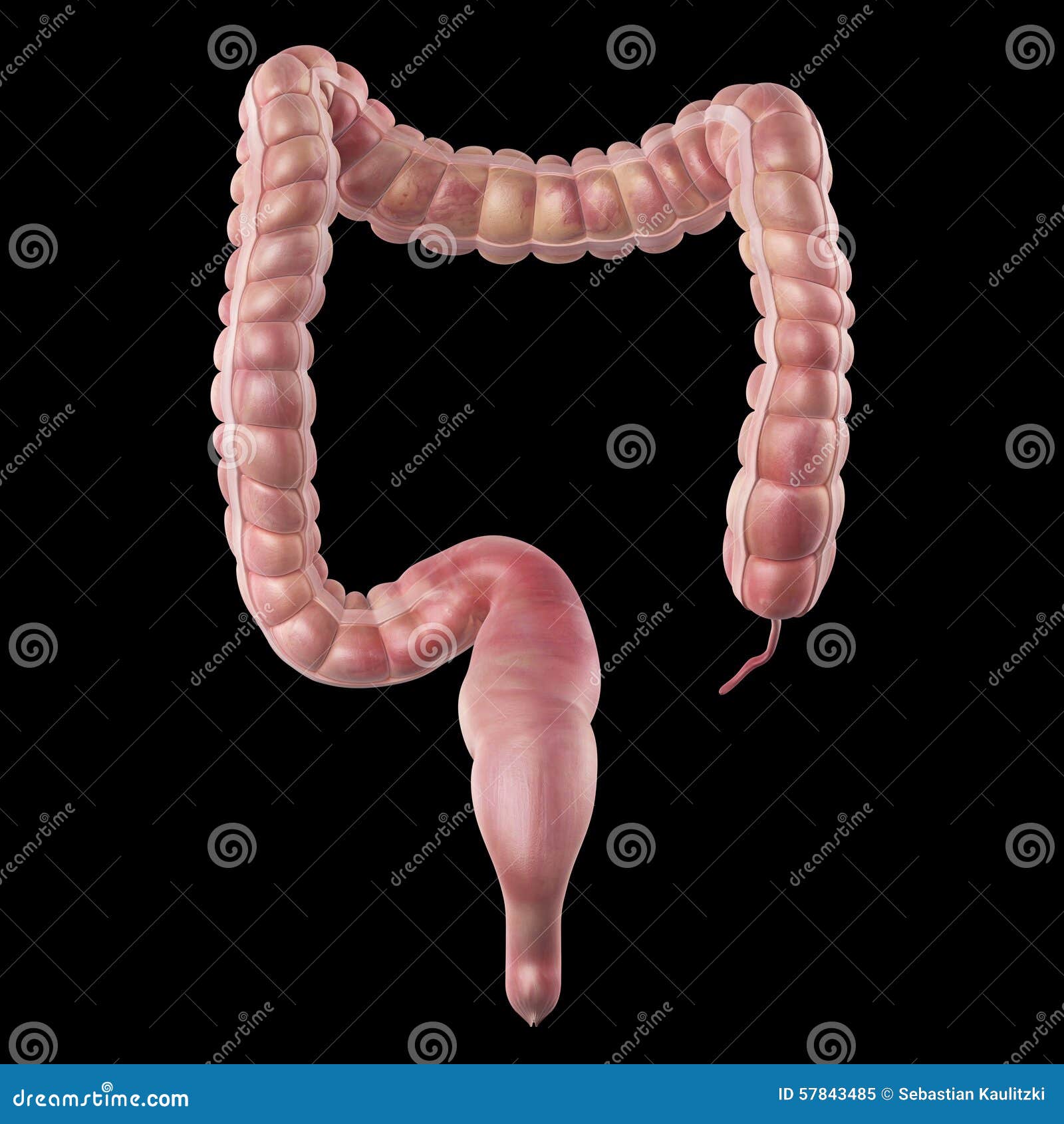 3d Illustration Of Colon Polyps. Polyp In The Intestine. Isolated White ...