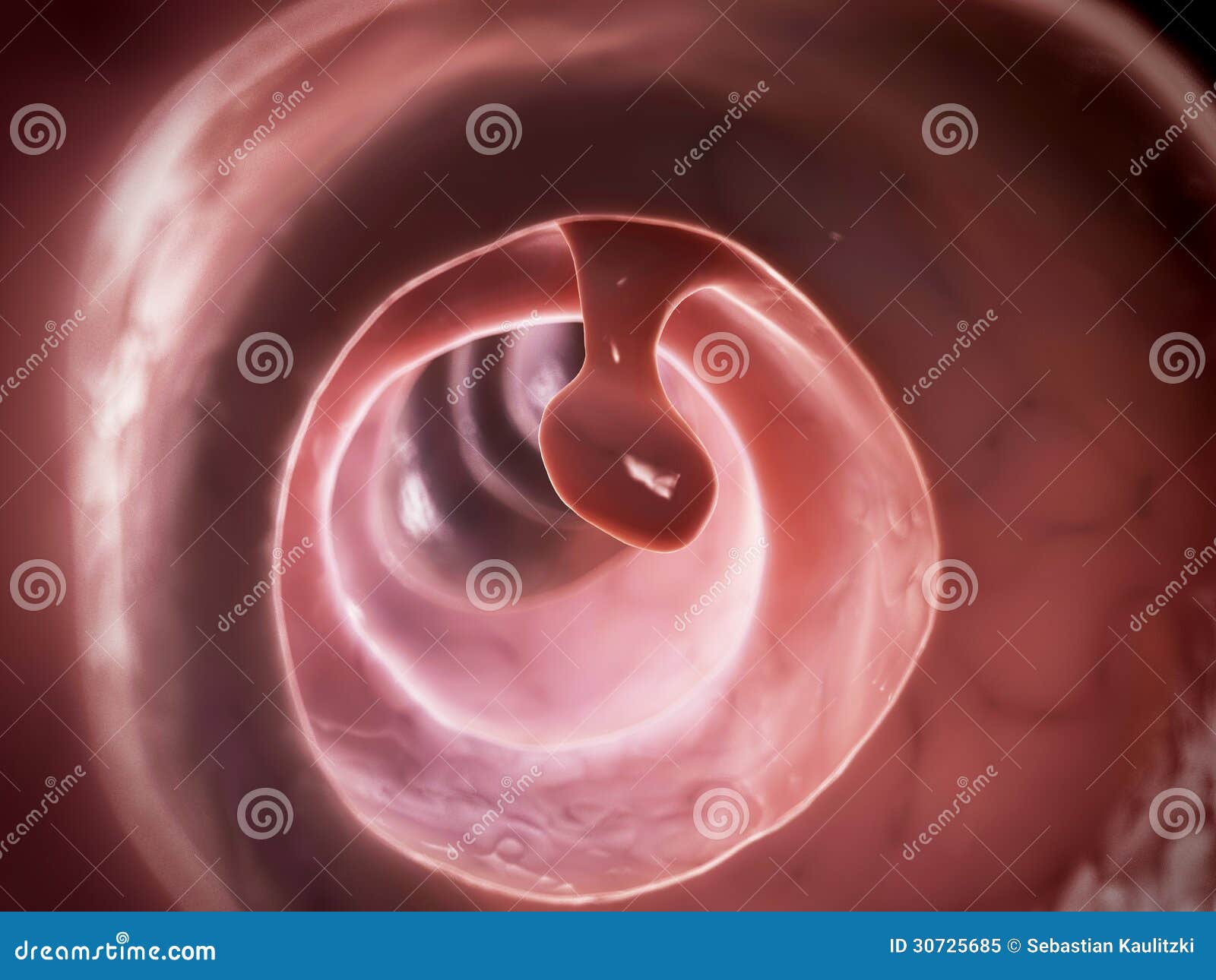 Colon polyp stock illustration. Illustration of endoscopic - 30725685