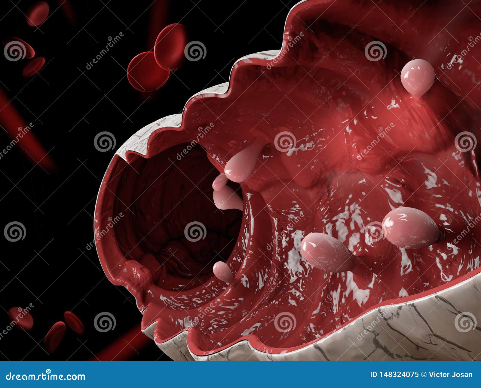 Colon Polyps. 3d Illustration, Polyp in the Intestine. Stock ...