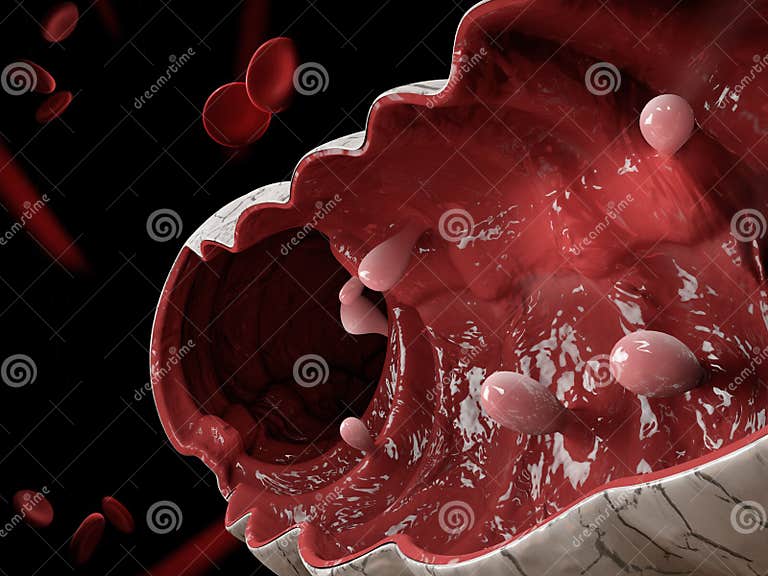 Colon Polyps. 3d Illustration, Polyp in the Intestine. Stock ...