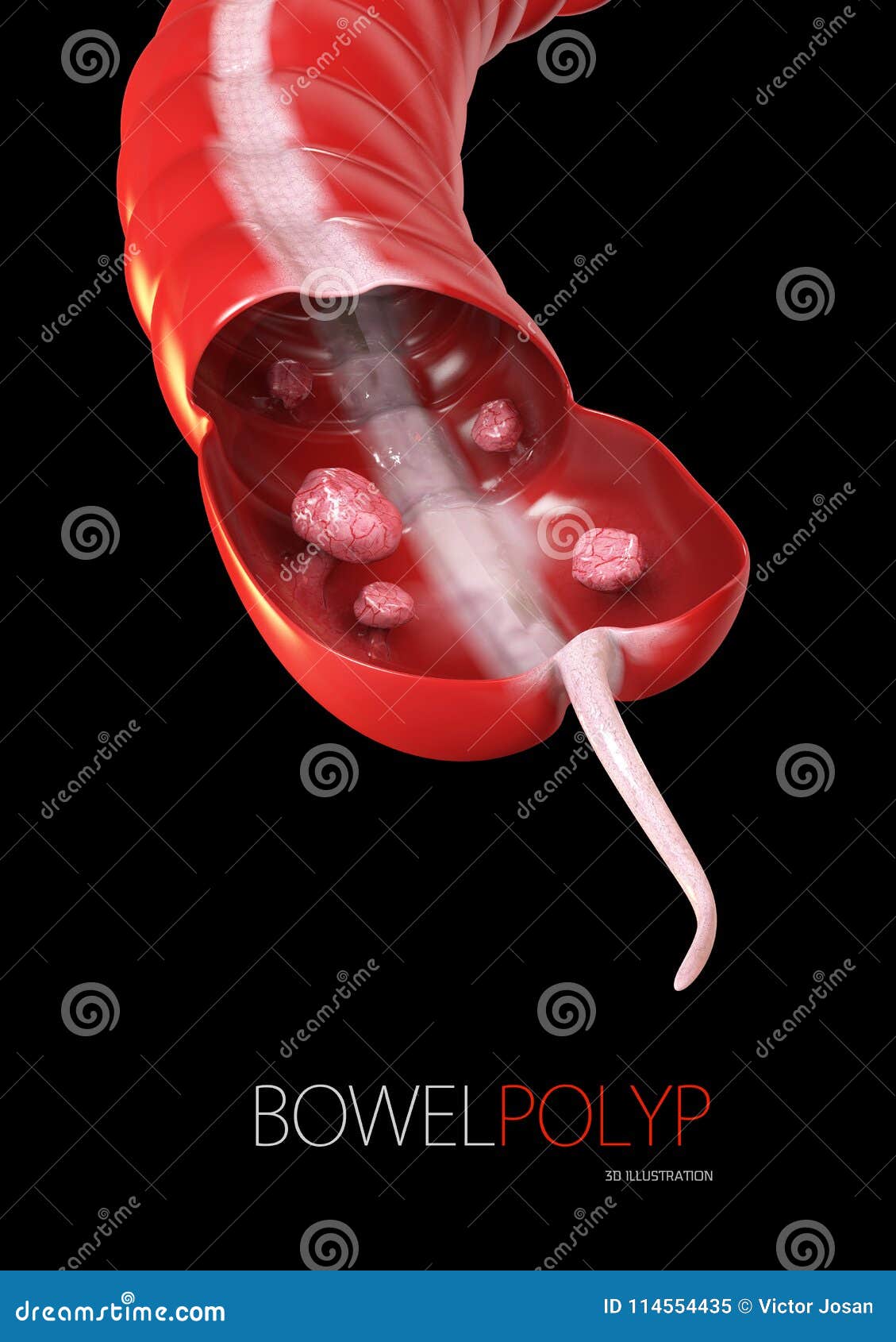 Colon Polyp Cartoon Vector | CartoonDealer.com #19947919