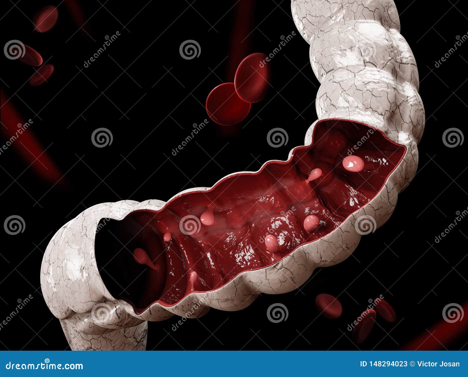 Colon Polyps. 3d Illustration, Polyp in the Intestine. Stock ...