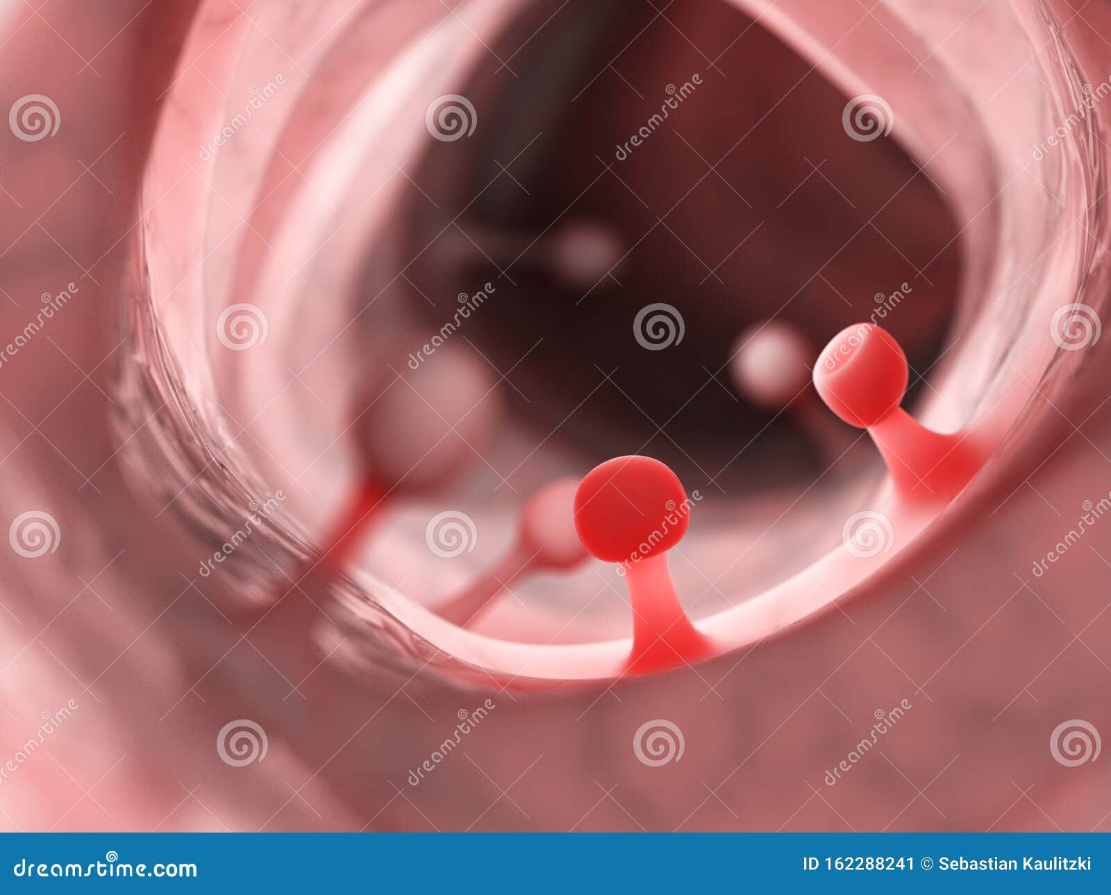 Polyps In The Colon. Removal Of Polyps Cartoon Vector | CartoonDealer ...