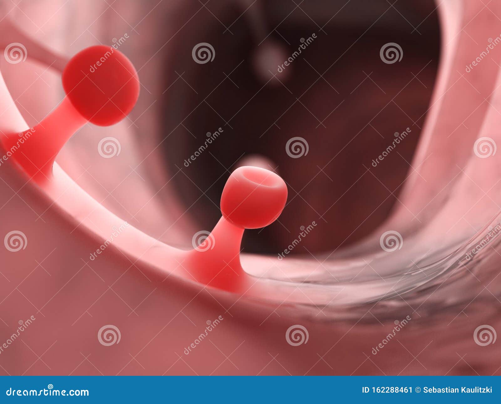Colon polyps stock illustration. Illustration of anatomy - 162288461