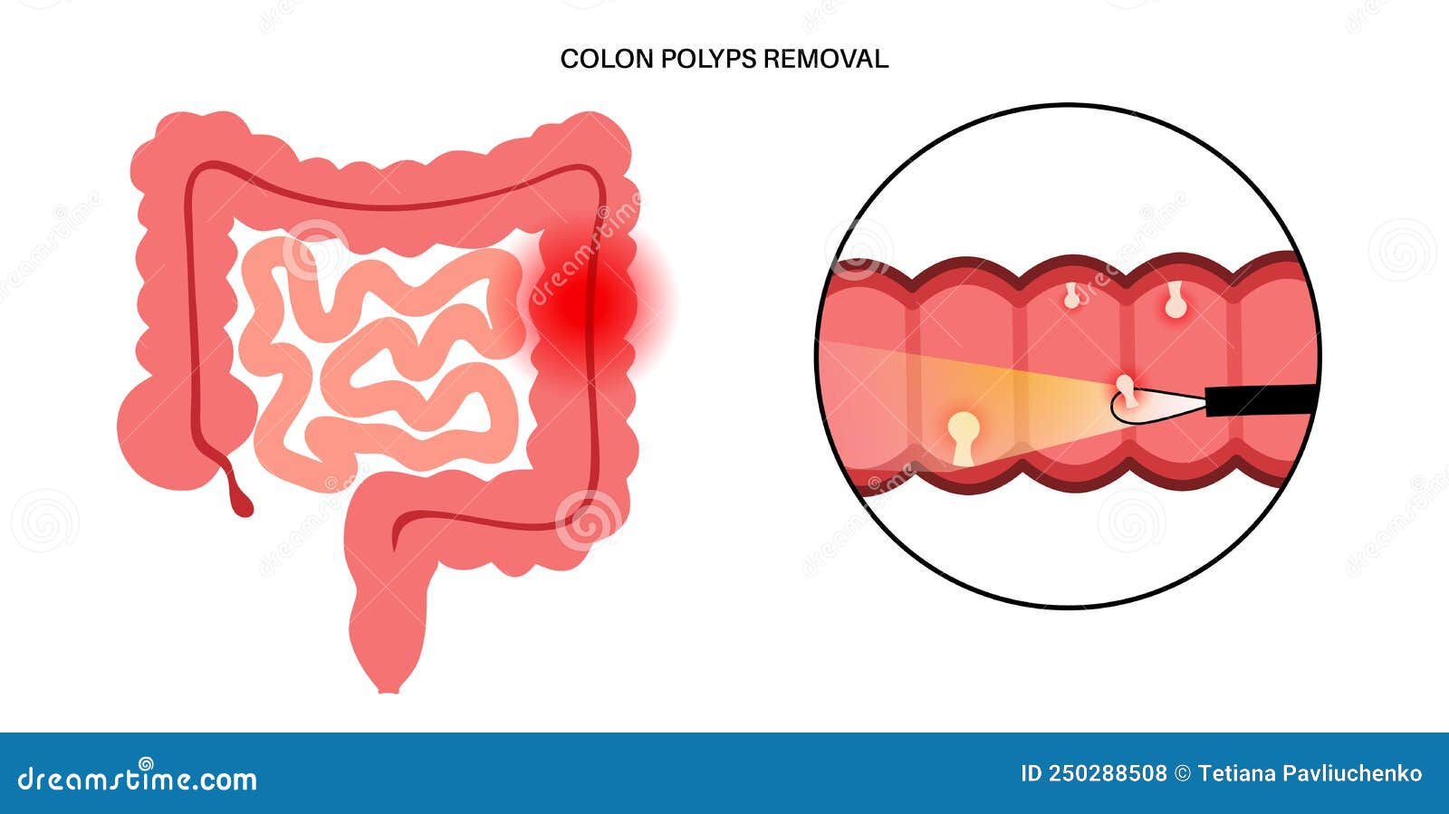 Colon Polyps Stock Illustration | CartoonDealer.com #162288355