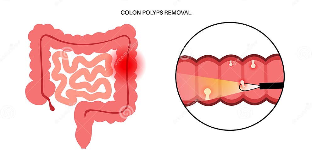 Colon polyps inflammation stock vector. Illustration of medicine ...