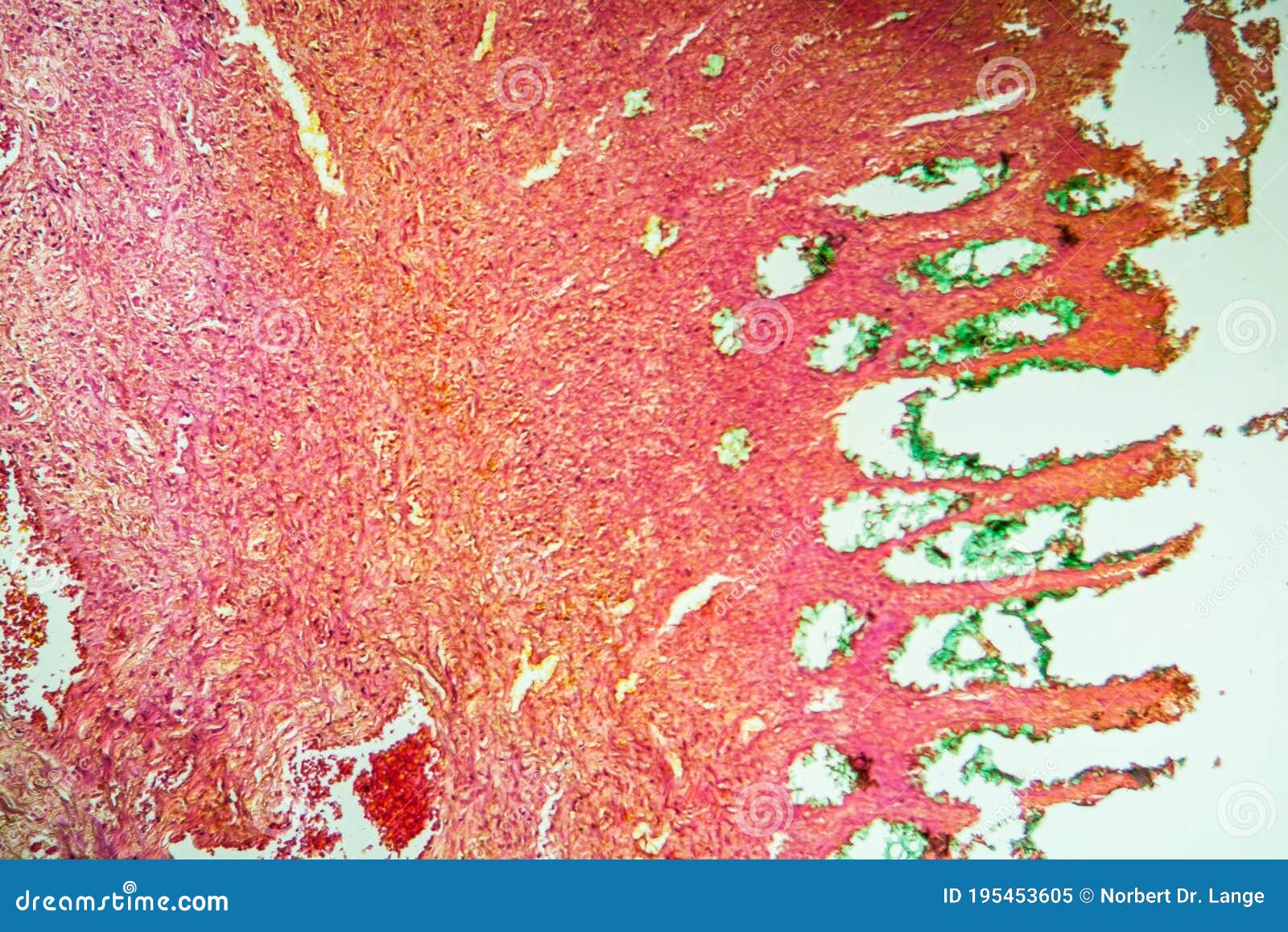 Colon Tissue with Diverticulum Stock Image - Image of microscopy ...
