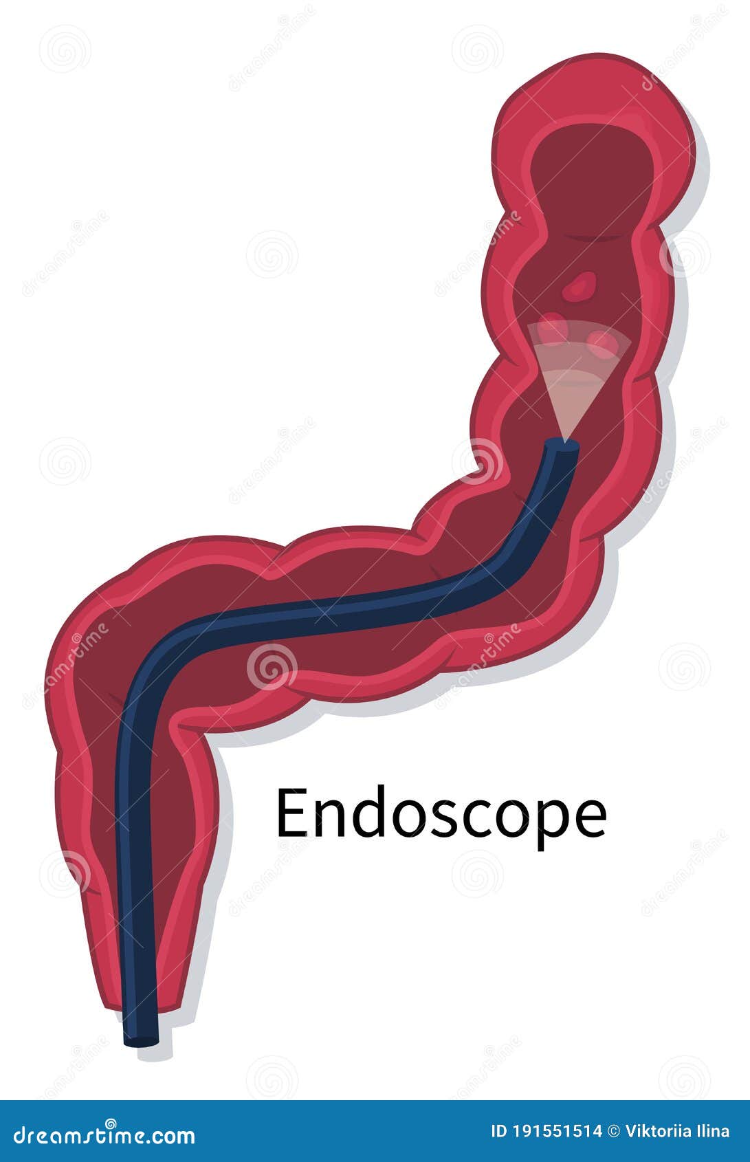 Colonoscopy - Is The Endoscopic Examination Of The Large Intestine And ... Colonoscopy - Is The Endoscopic Examination Of The Large Intestine And ...