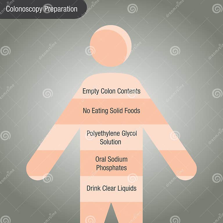 Colonoscopy Chart stock vector. Illustration of colon - 43877789