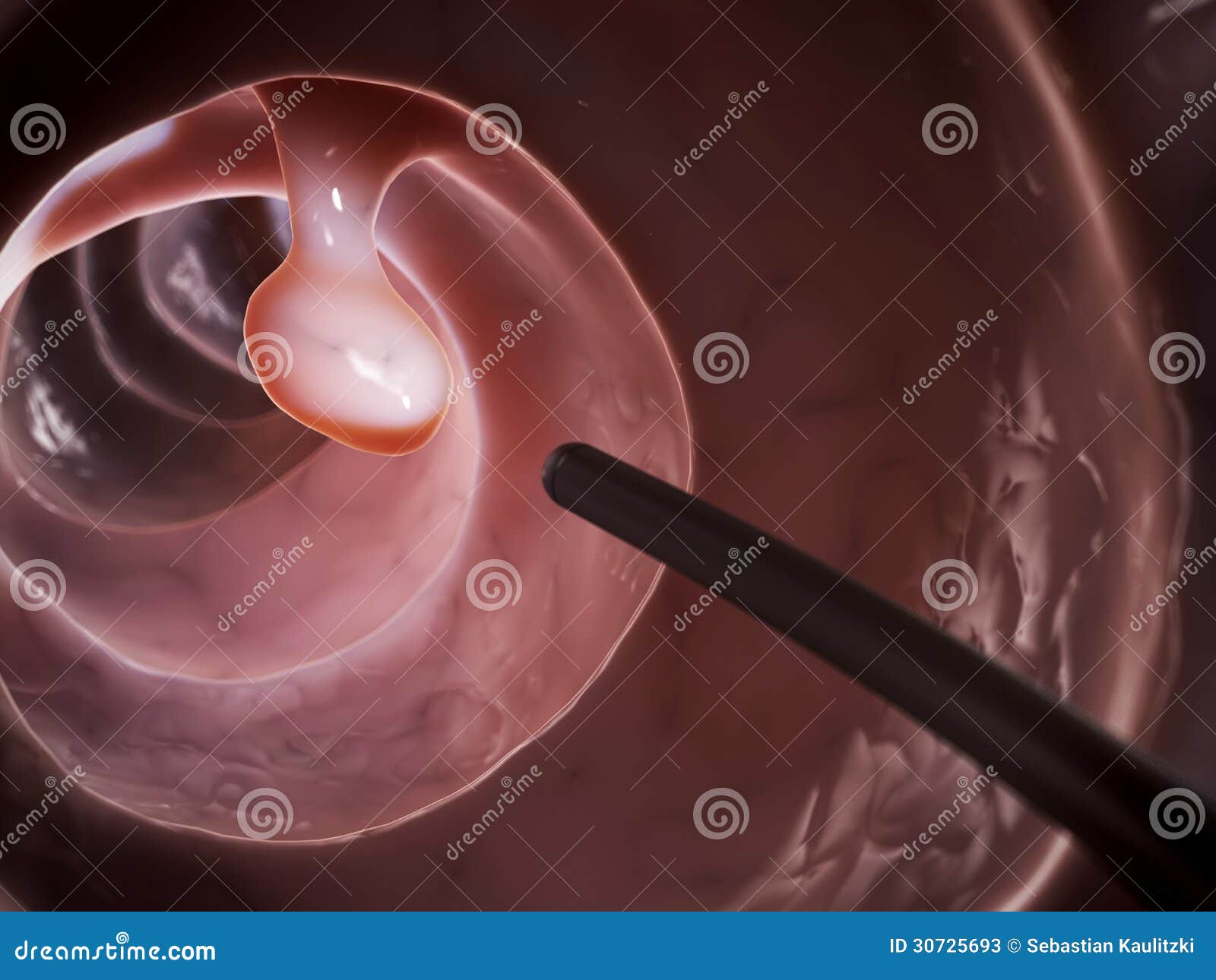 Colonoscopy stock illustration. Illustration of chemotherapy - 30725693
