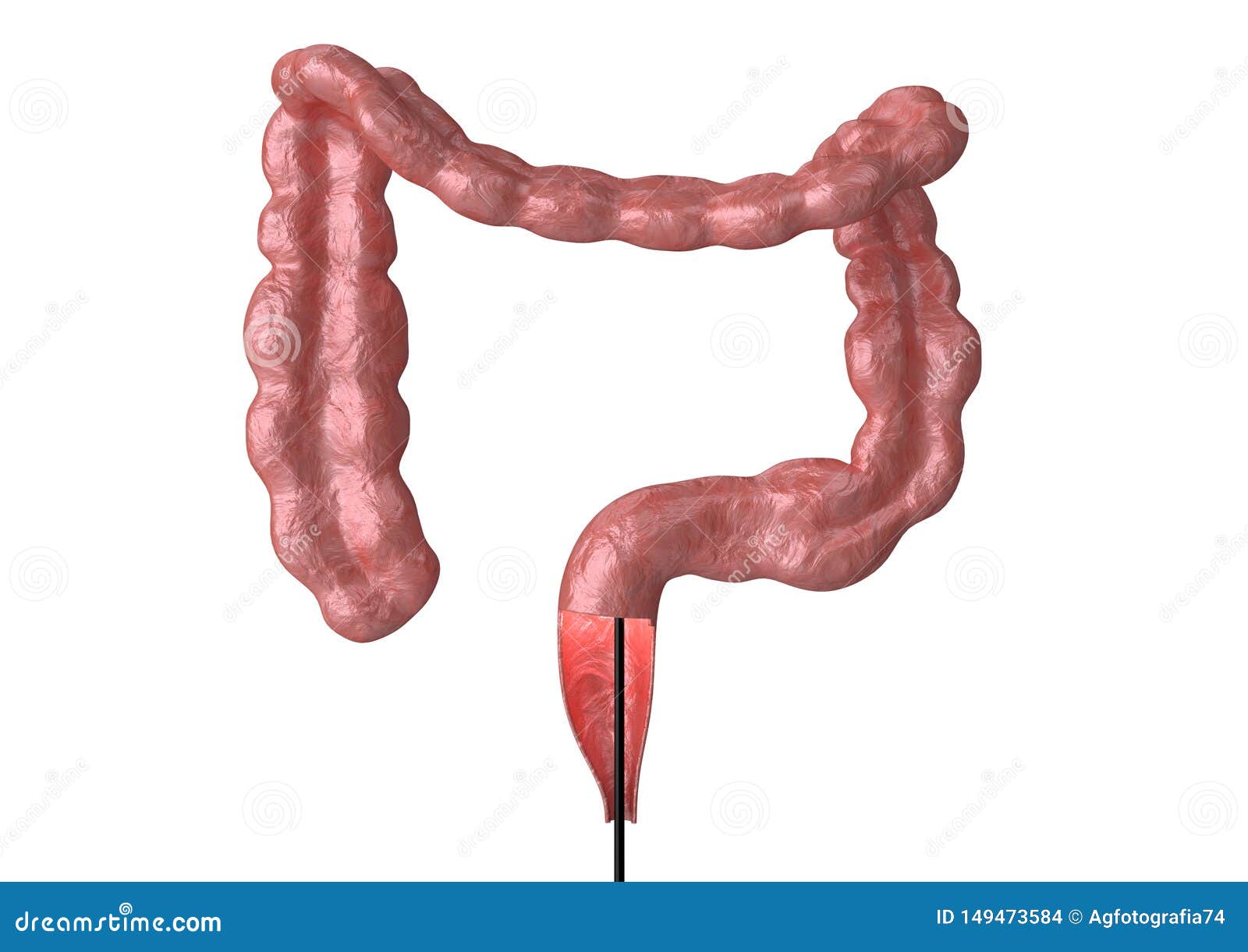 Colonoscopy - Is The Endoscopic Examination Of The Large Intestine And ... Colonoscopy - Is The Endoscopic Examination Of The Large Intestine And ...