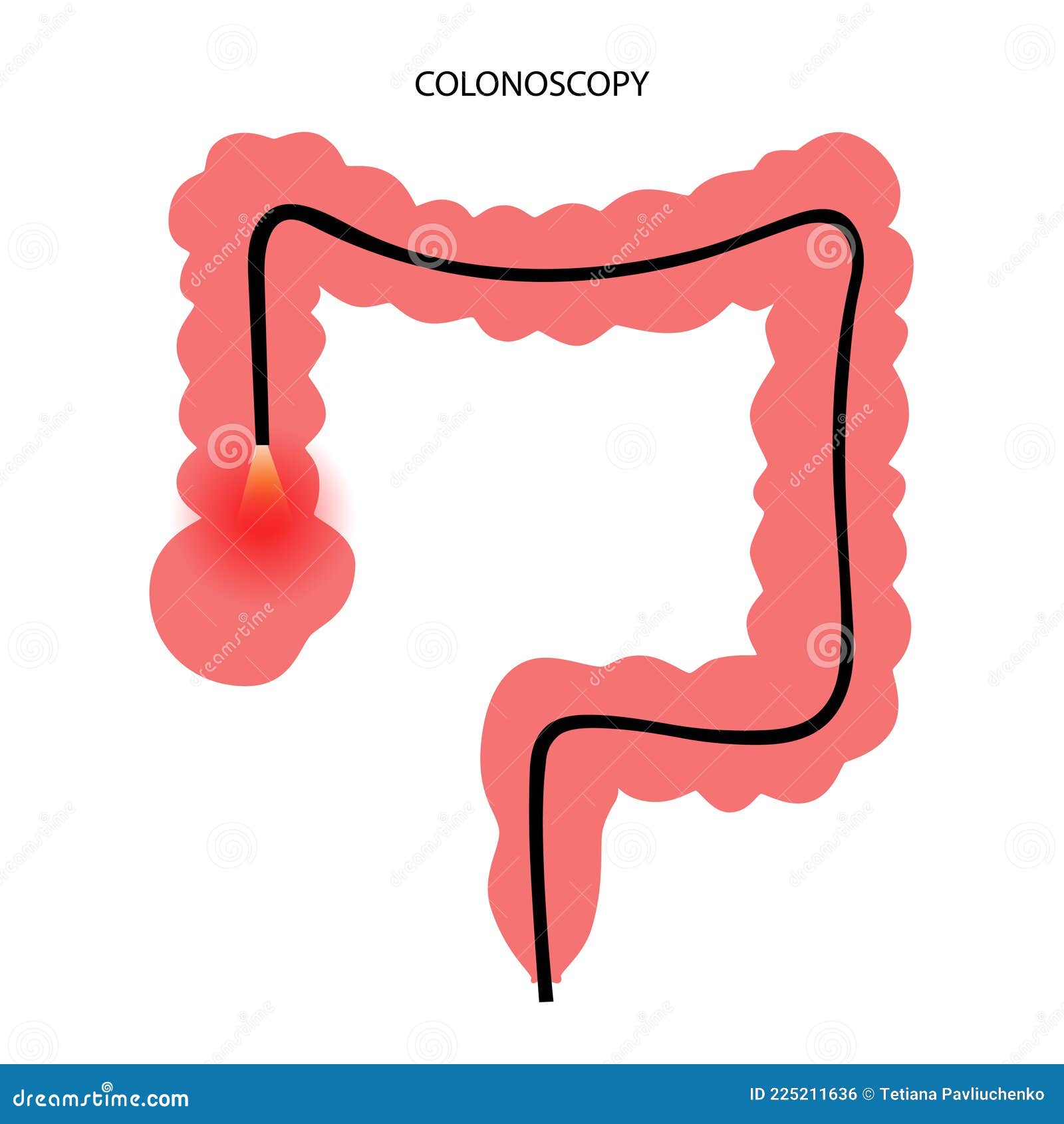 Colonoscopy Procedure Concept Stock Vector - Illustration of intestine ...