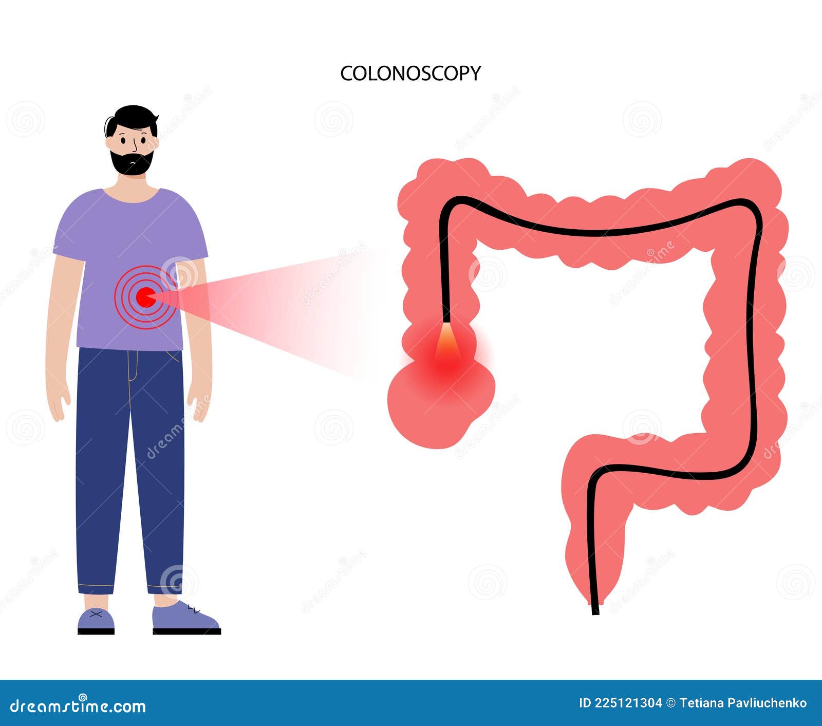 Colonoscopy Procedure Concept Stock Vector - Illustration of endoscope ...