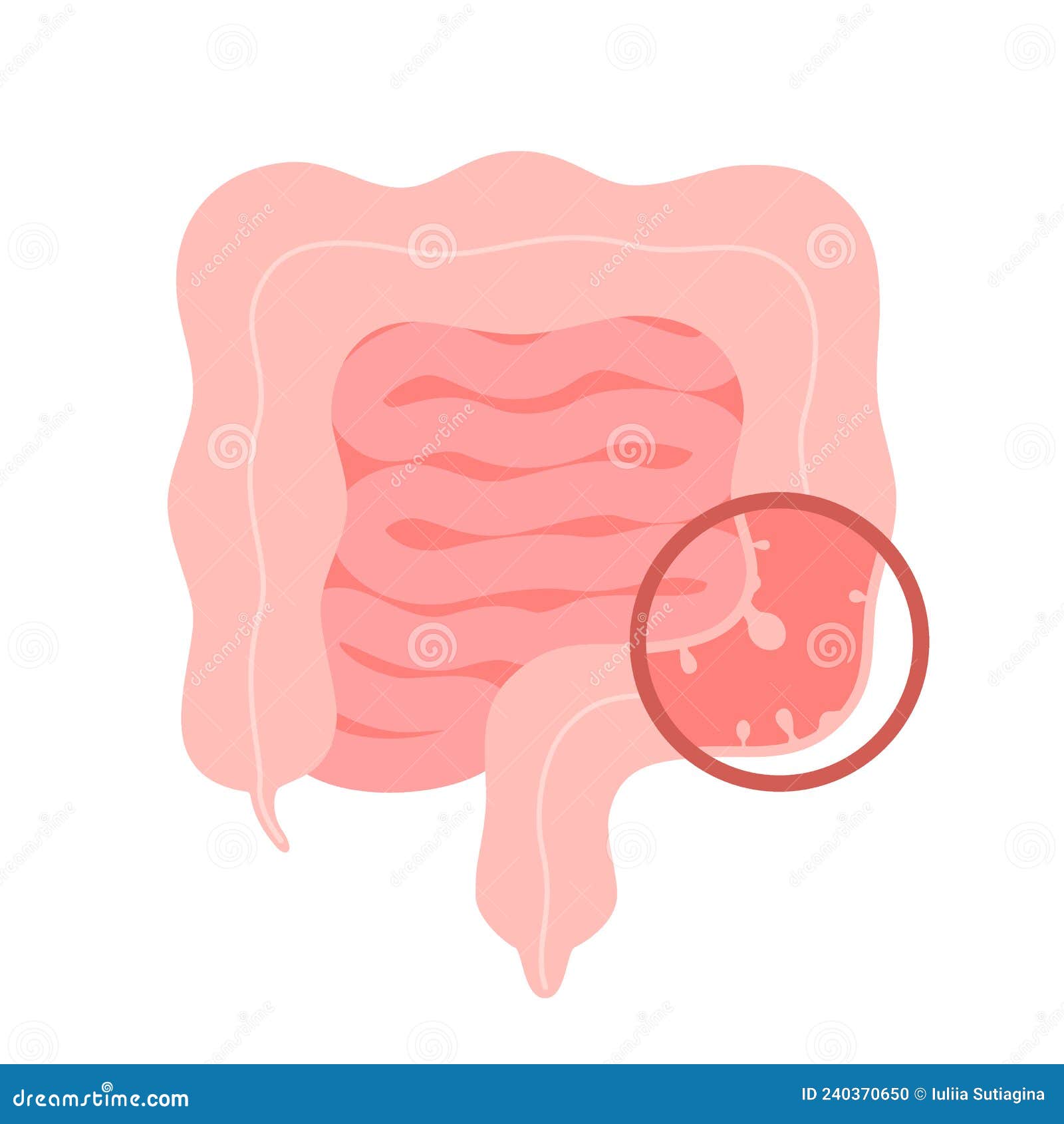 Colonoscopy Intestine, Polypectomy Procedure, Removal Polyp In Colon ...