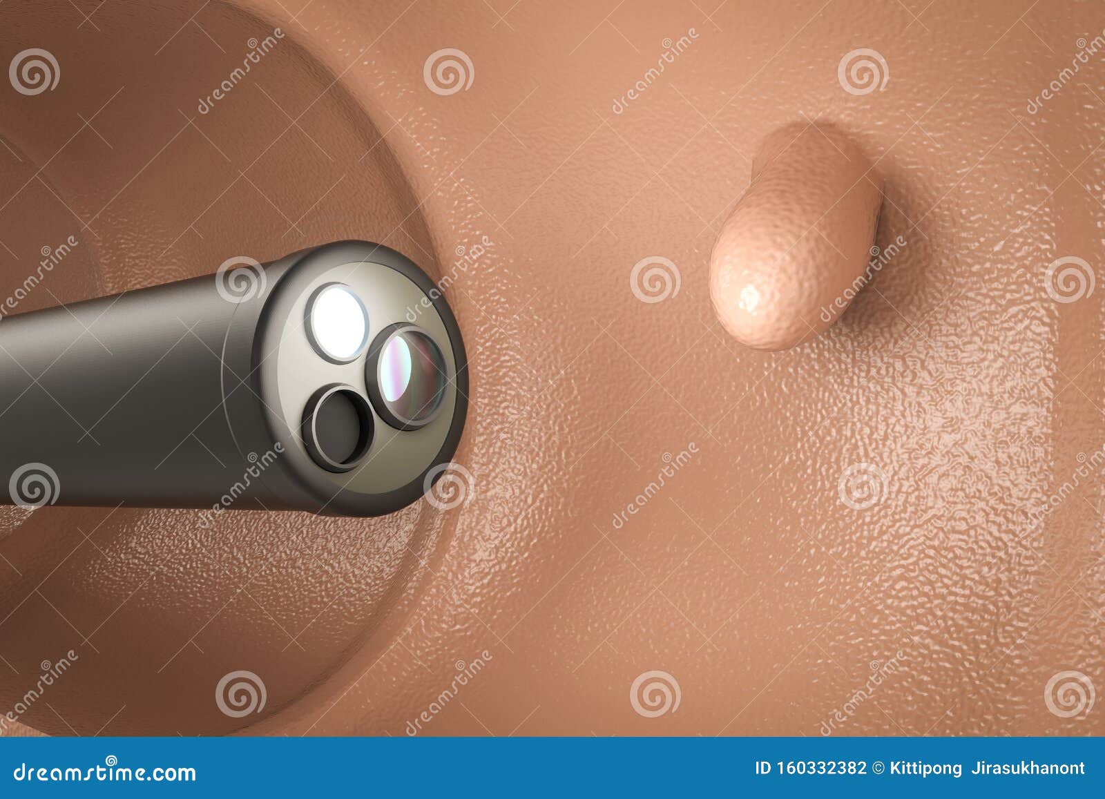 Colonoscopy Technology Concept Stock Illustration - Illustration of ...