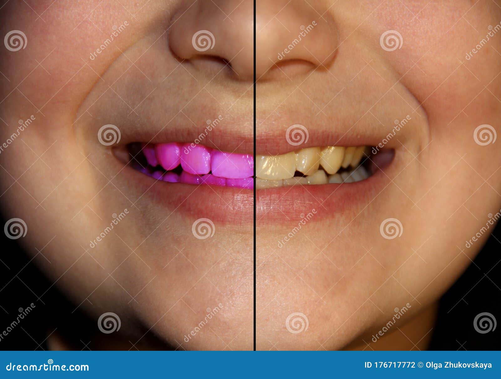 Colored Teeth. Bacteria and Microbes on Your Teeth Stock Photo - Image ...
