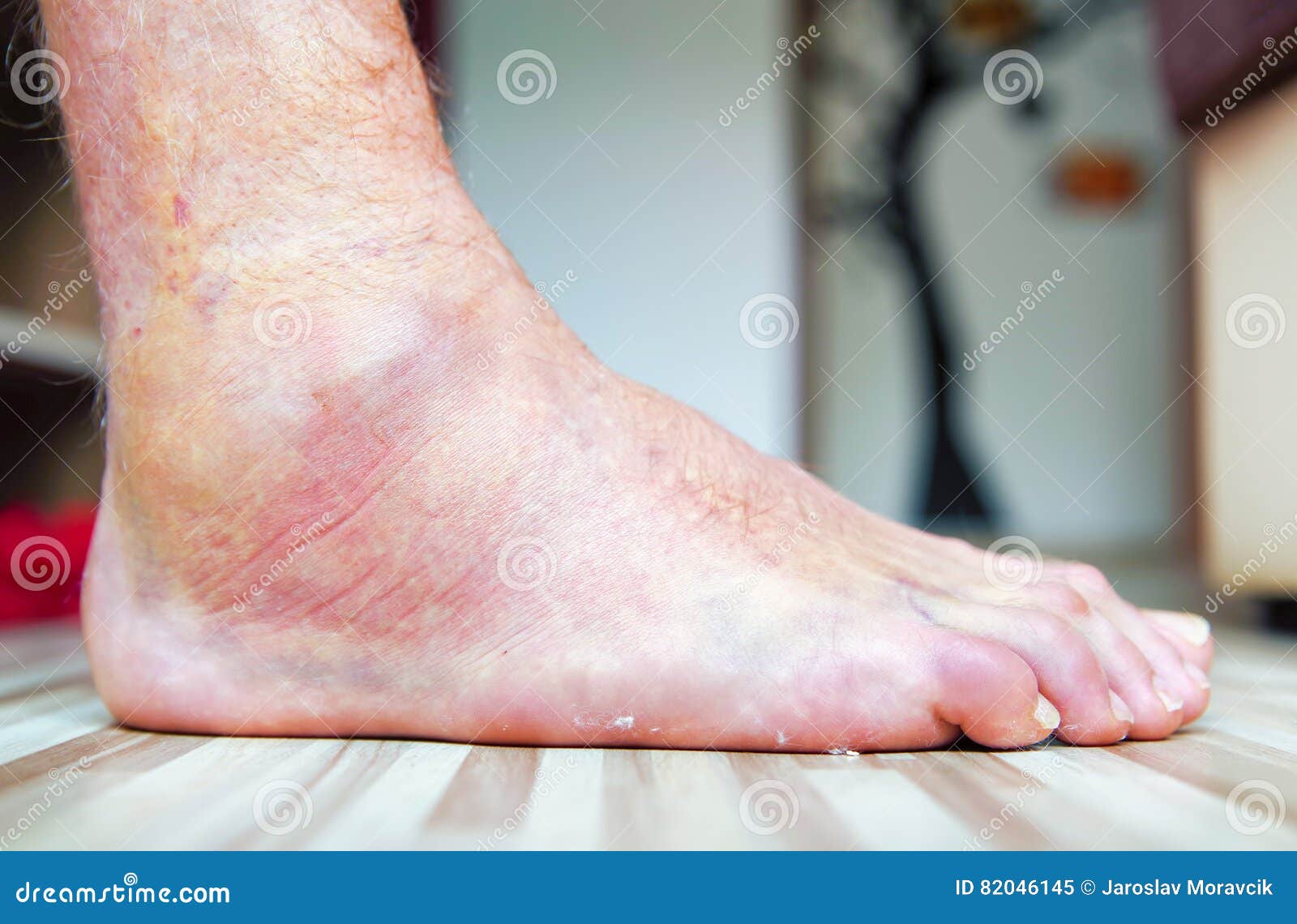 Colorful broken leg stock image. Image of injury, accident - 82046145