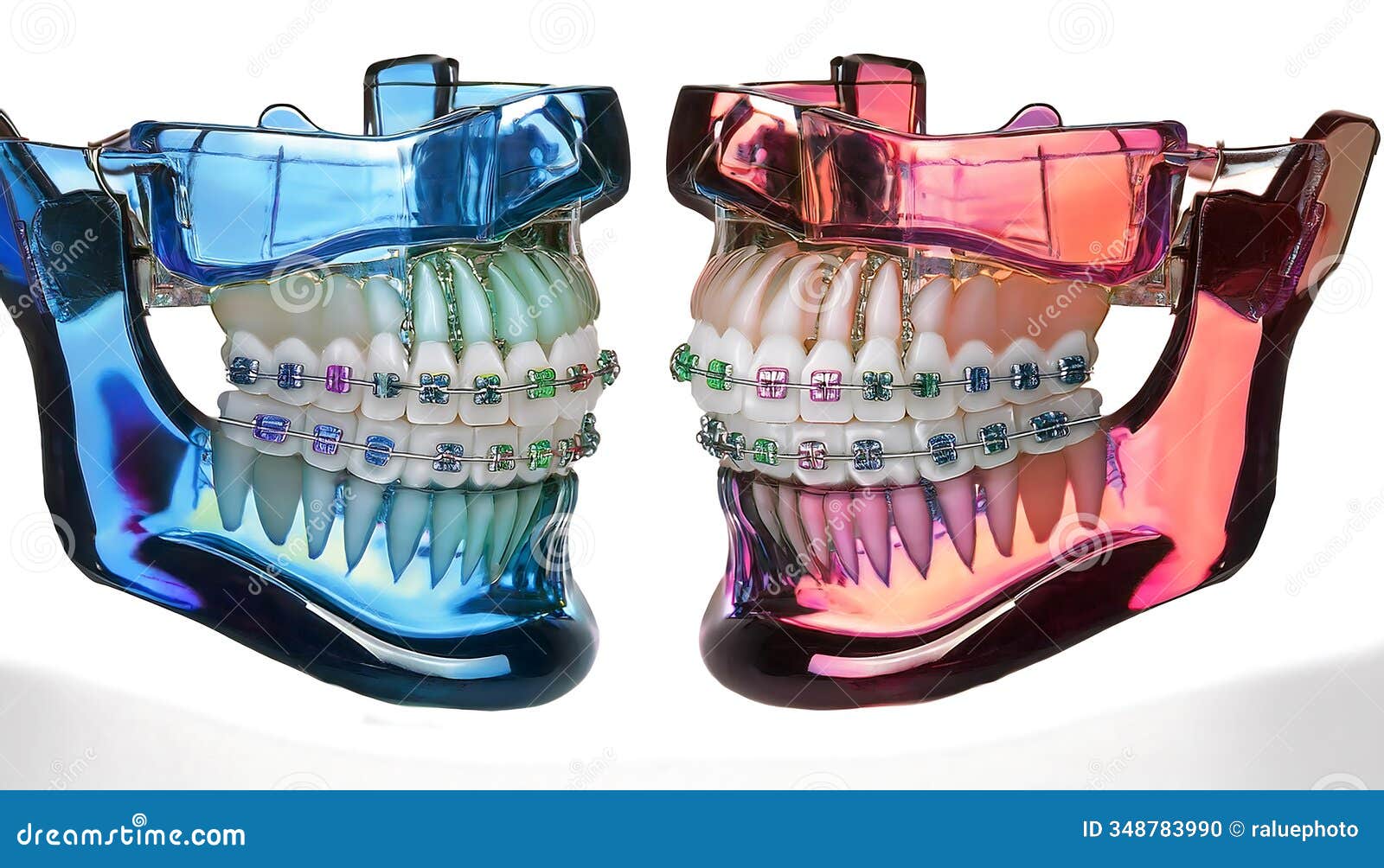 Colorful Human Jaw with Braces, Metal and Ceramic Braces Stock ...
