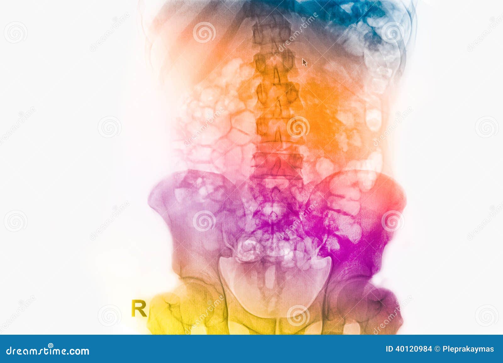Colorful Pelvic and Spinal Coloum X-rays Image Stock Photo - Image of ...