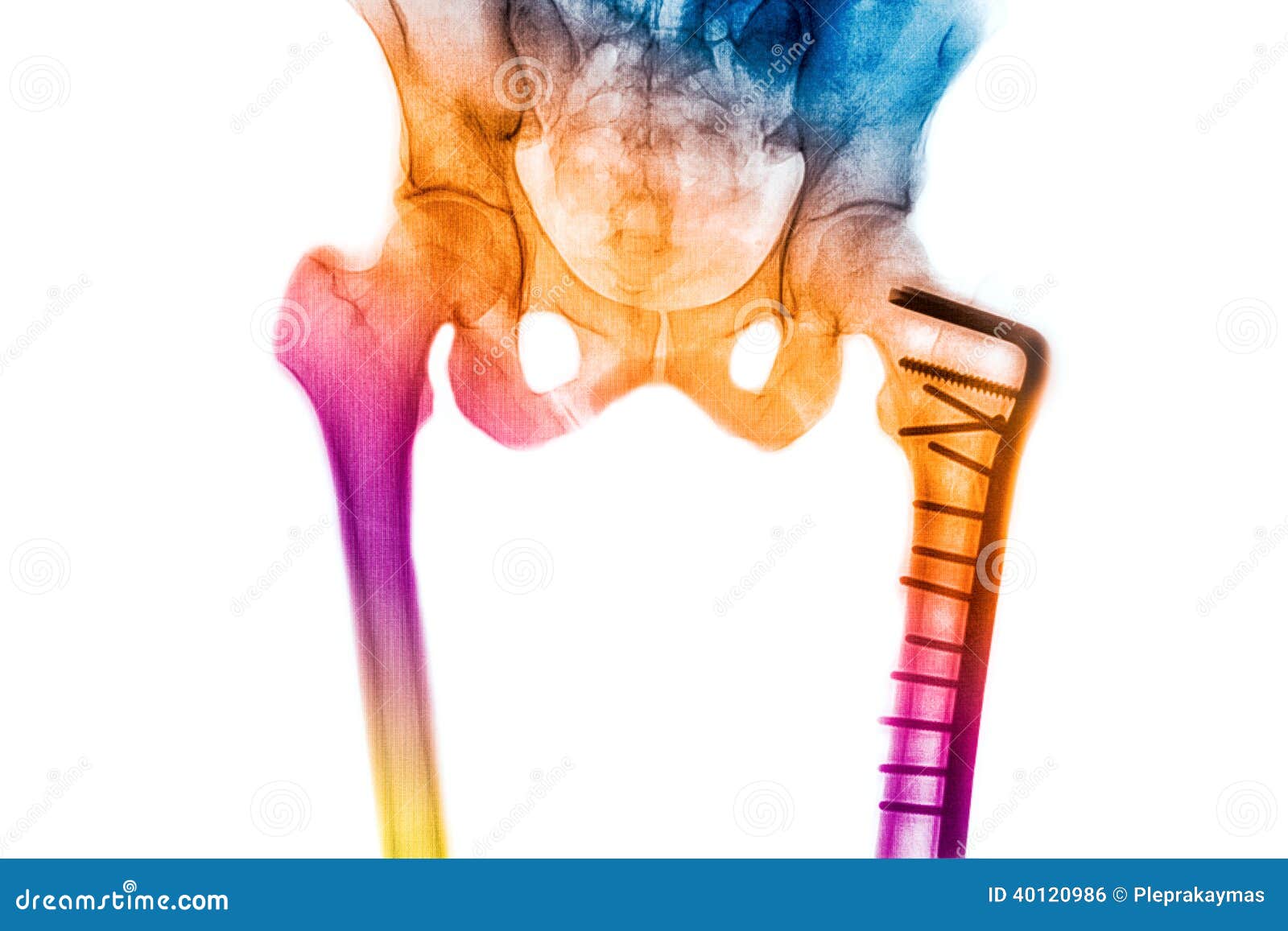 Colorful X-rays Image Show Broken Hip Joint Stock Photo - Image of ...