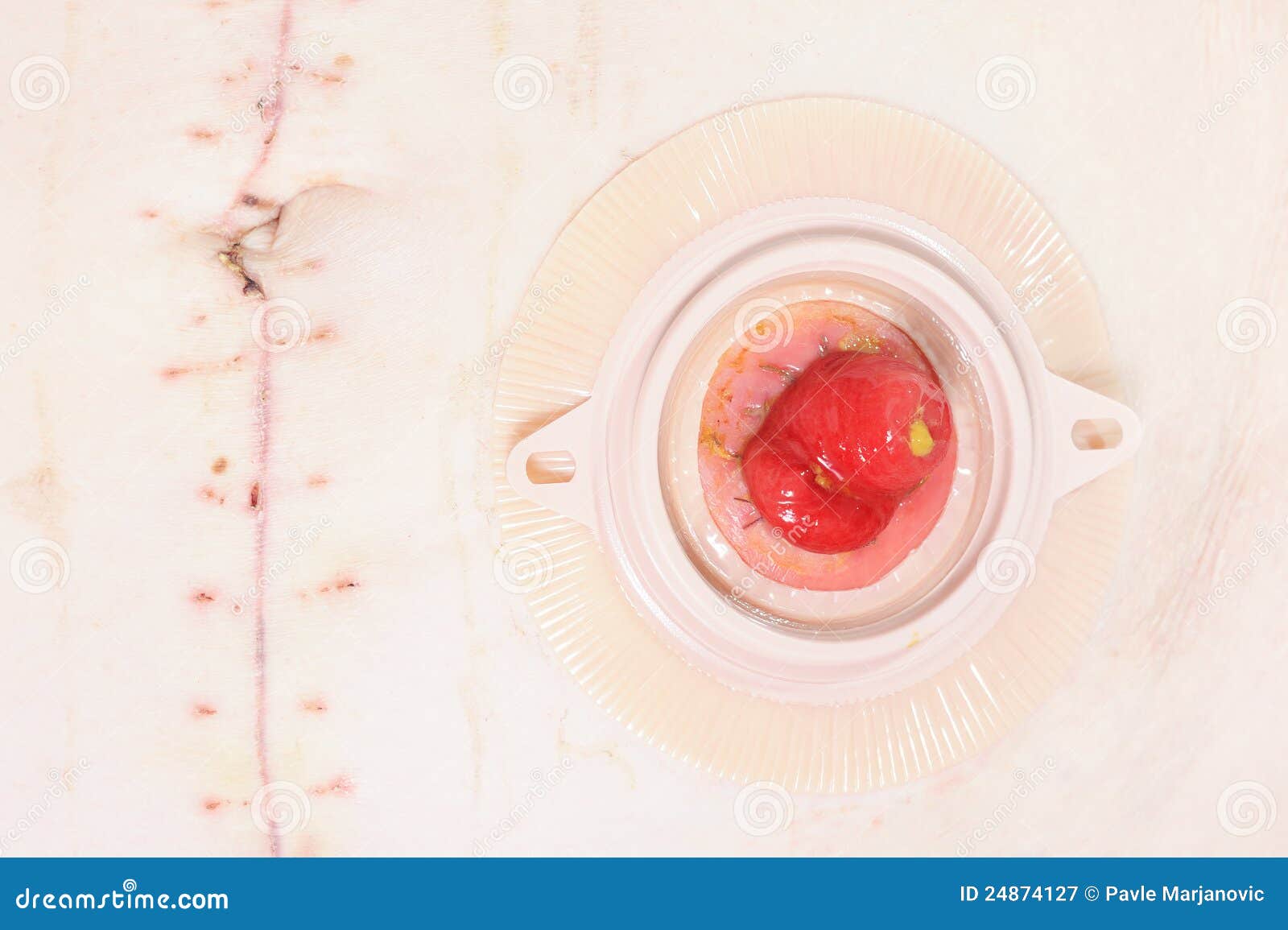 Colostomy stock image. Image of anatomy, operation, medical - 24874127