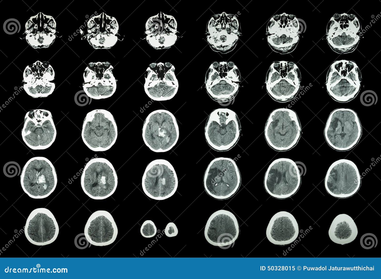 Colpo Emorragico E Colpo Ischemico Immagine Stock - Immagine di ...