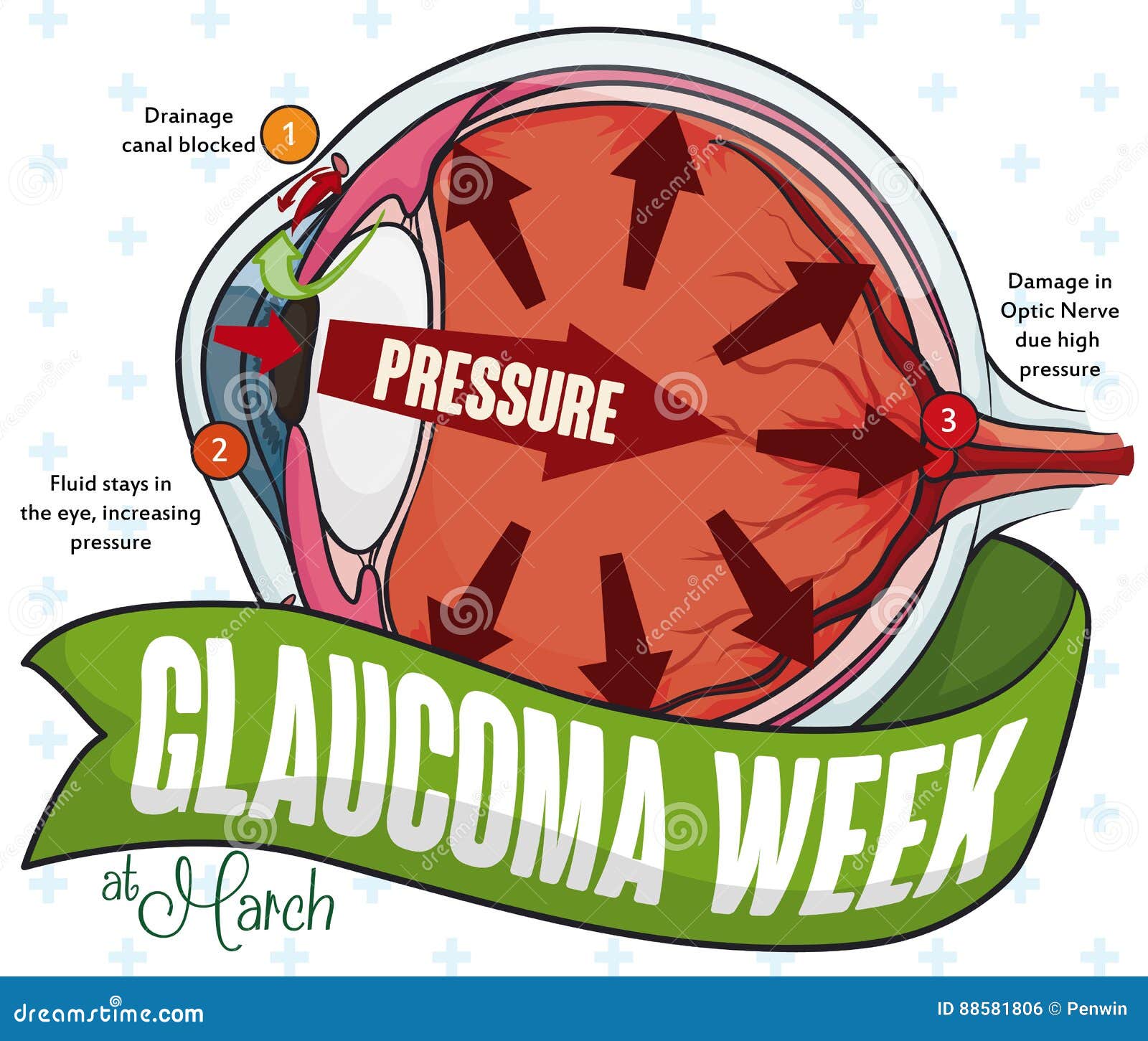 Commemorative Infographic for Glaucoma Week Celebration, Vector ...